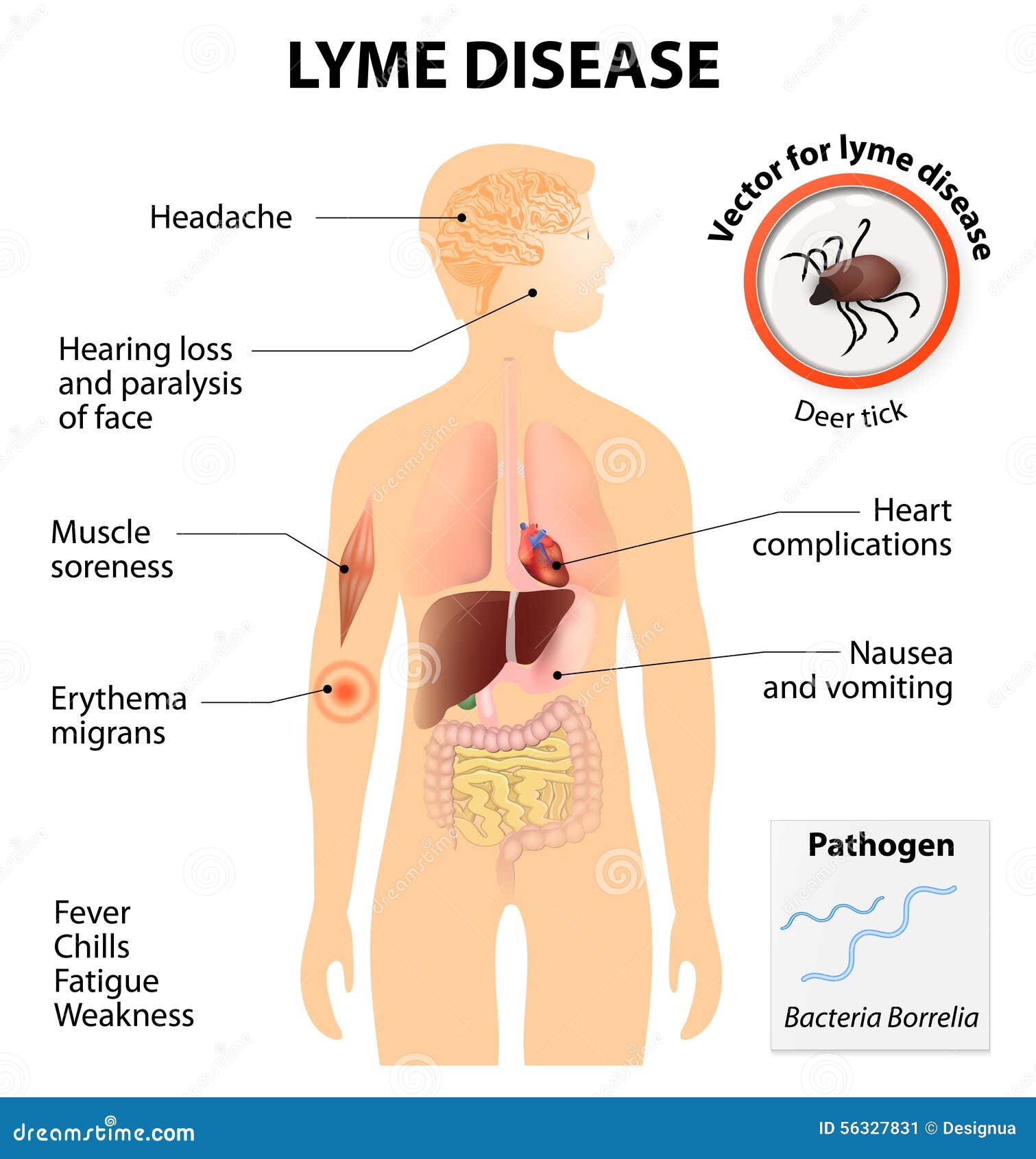 Lyme Disease Or Lyme Borreliosis Stock Vector - Image: 56327831 Lyme Disease Or Lyme Borreliosis Stock Vector - Image: 56327831