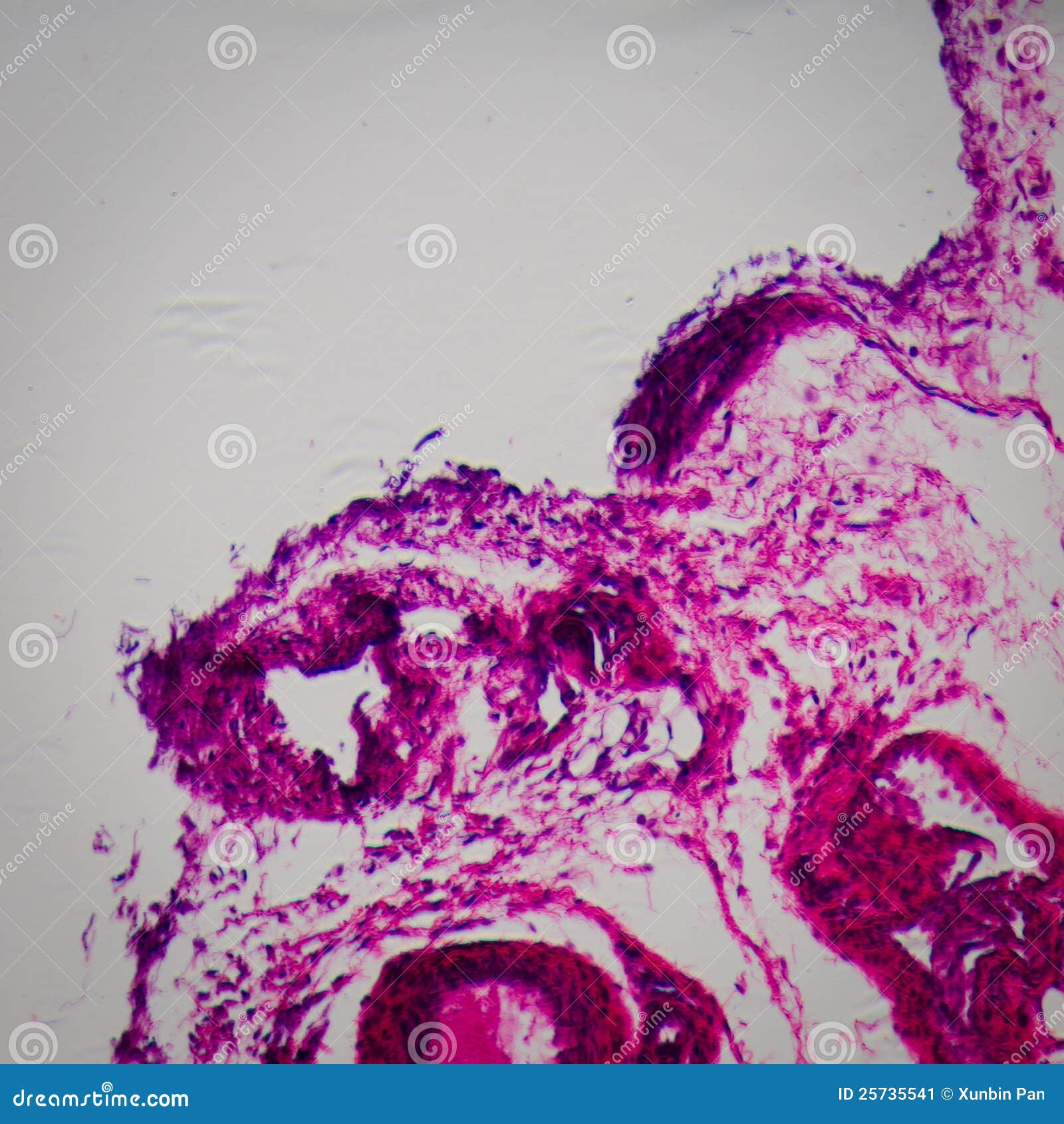 Lymph gland tissue stock image. Image of anatomy, leukemia - 25735541