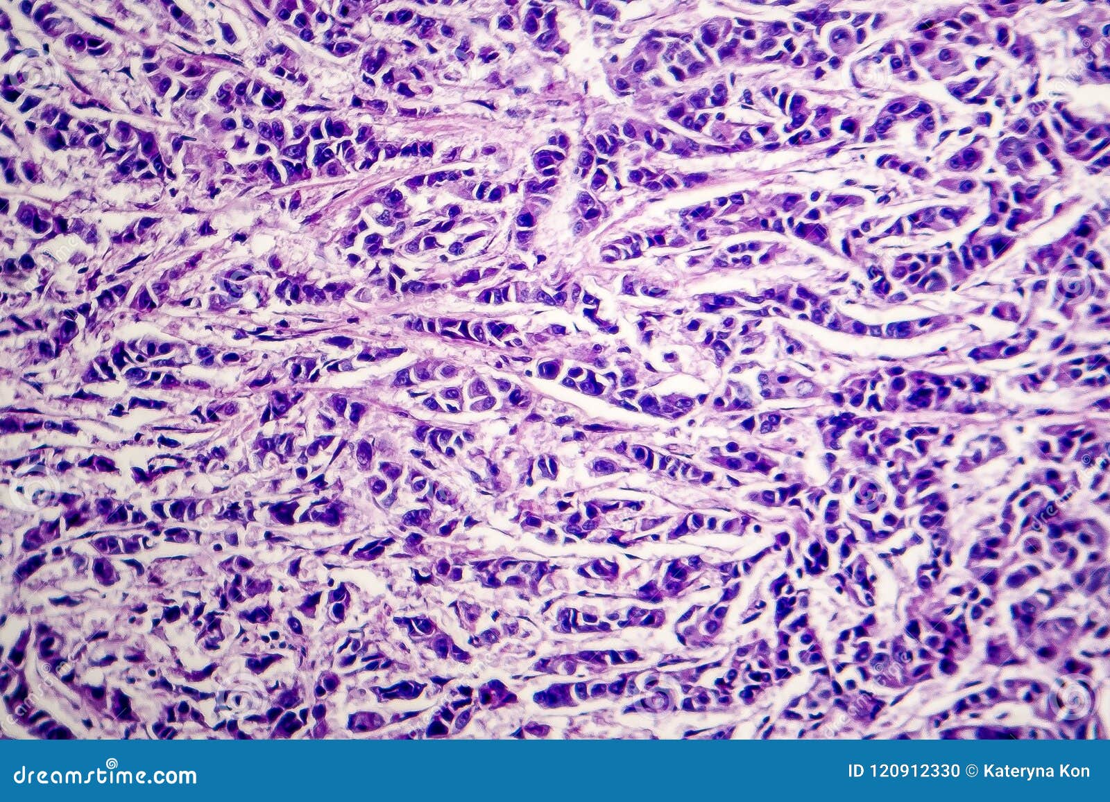 Lymph node cancer stock photo. Image of cell, microscope - 120912330