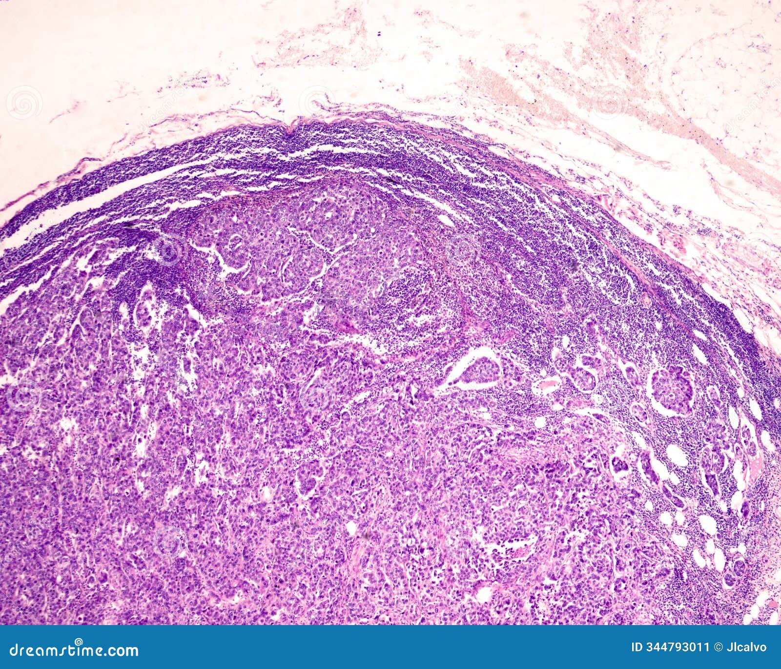 Lymph Node. Carcinoma Metastasis Royalty-Free Stock Photography ...