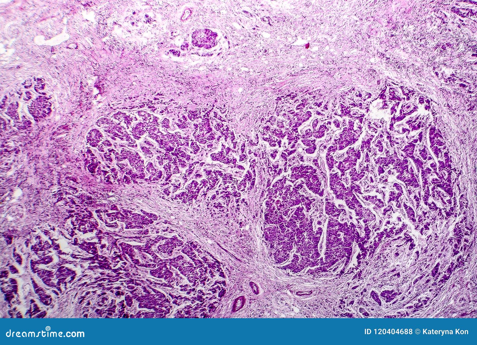 Lymph node metastasis stock photo. Image of microphotograph - 120404688