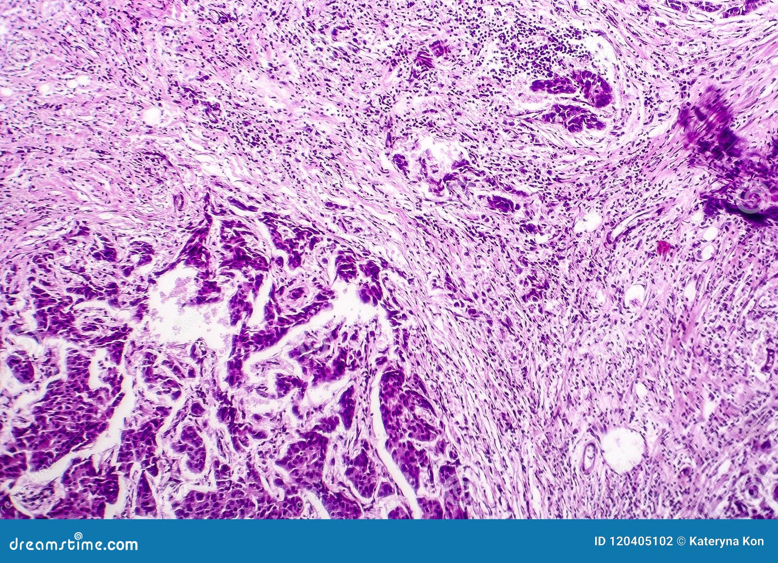 Histopathology Of Lymph Nodal Tuberculosis Royalty-Free Stock Photo ...