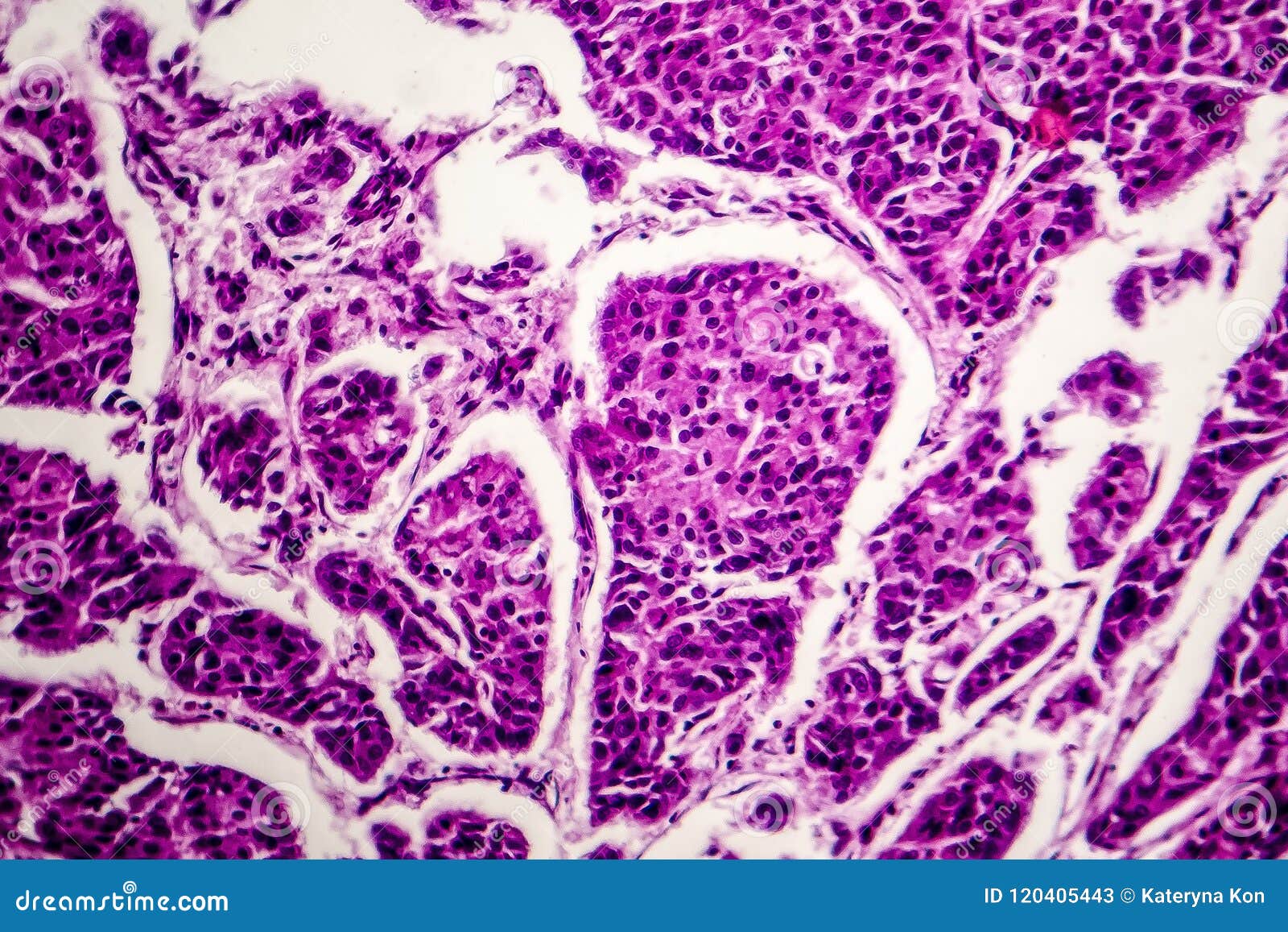 Lymph node metastasis stock image. Image of metastatic - 120405443