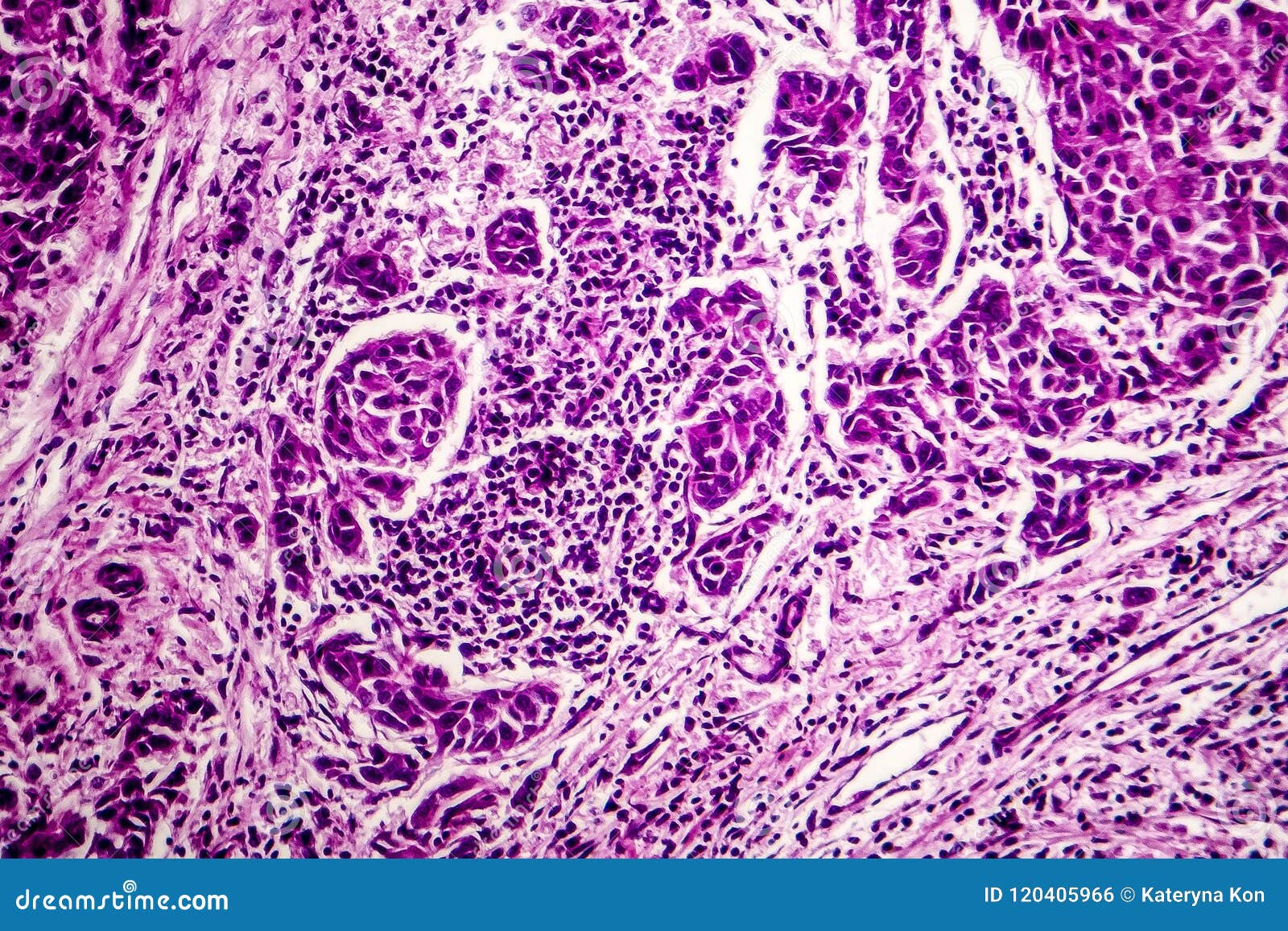 Lymph node metastasis stock photo. Image of micro, oncology - 120405966