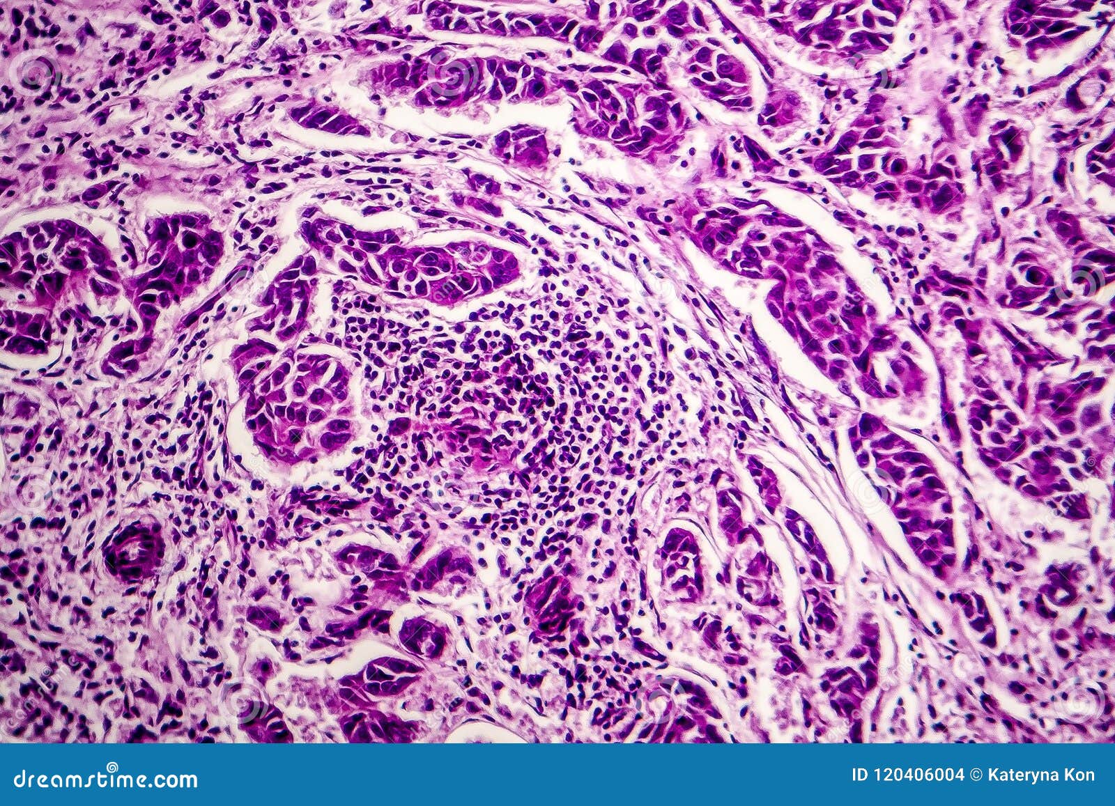 Lymph Node Cells Under The Microscope. Royalty-Free Stock Image ...