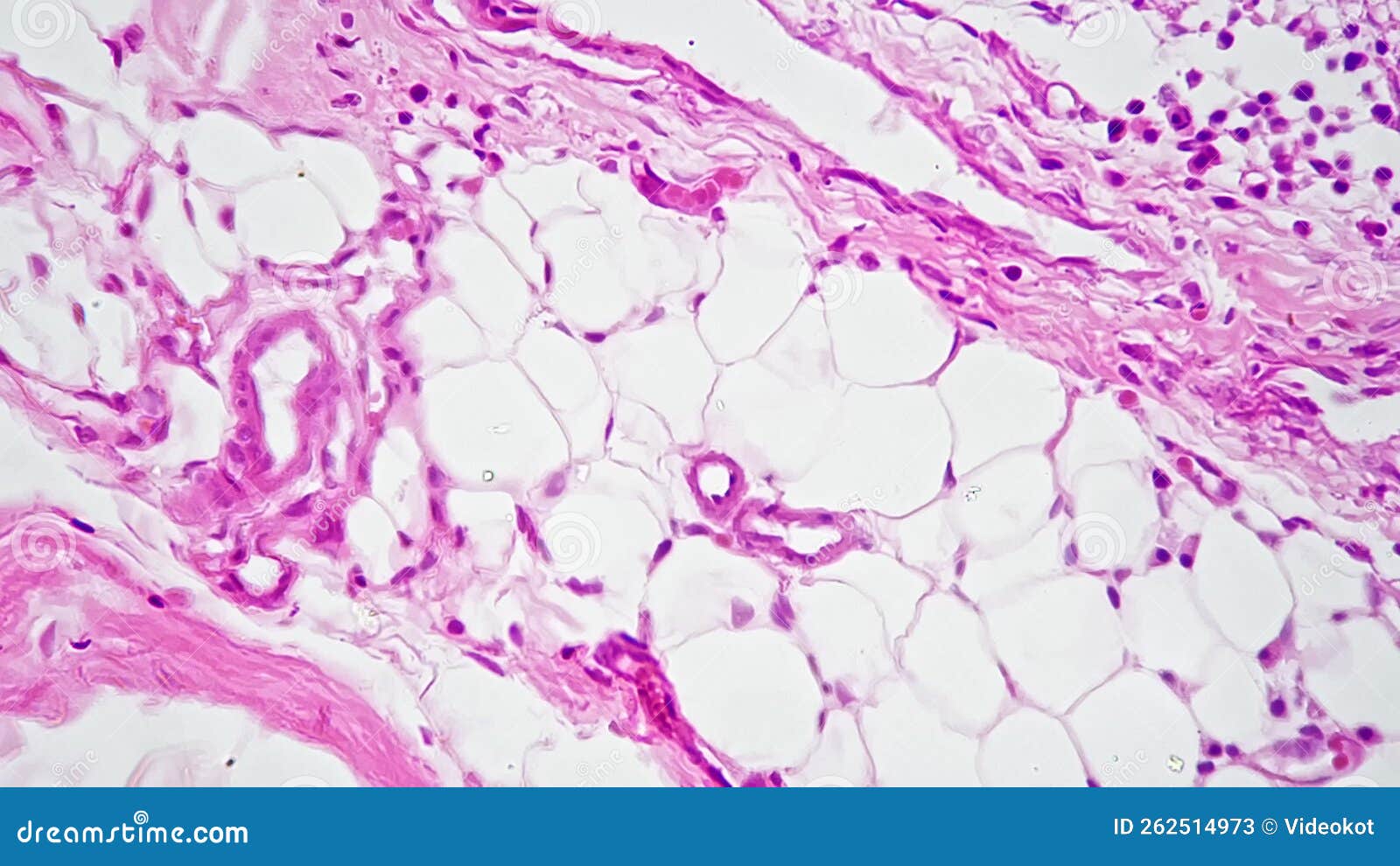 Lymph Node in Section Magnified Under Microscope in 400x Times on ...