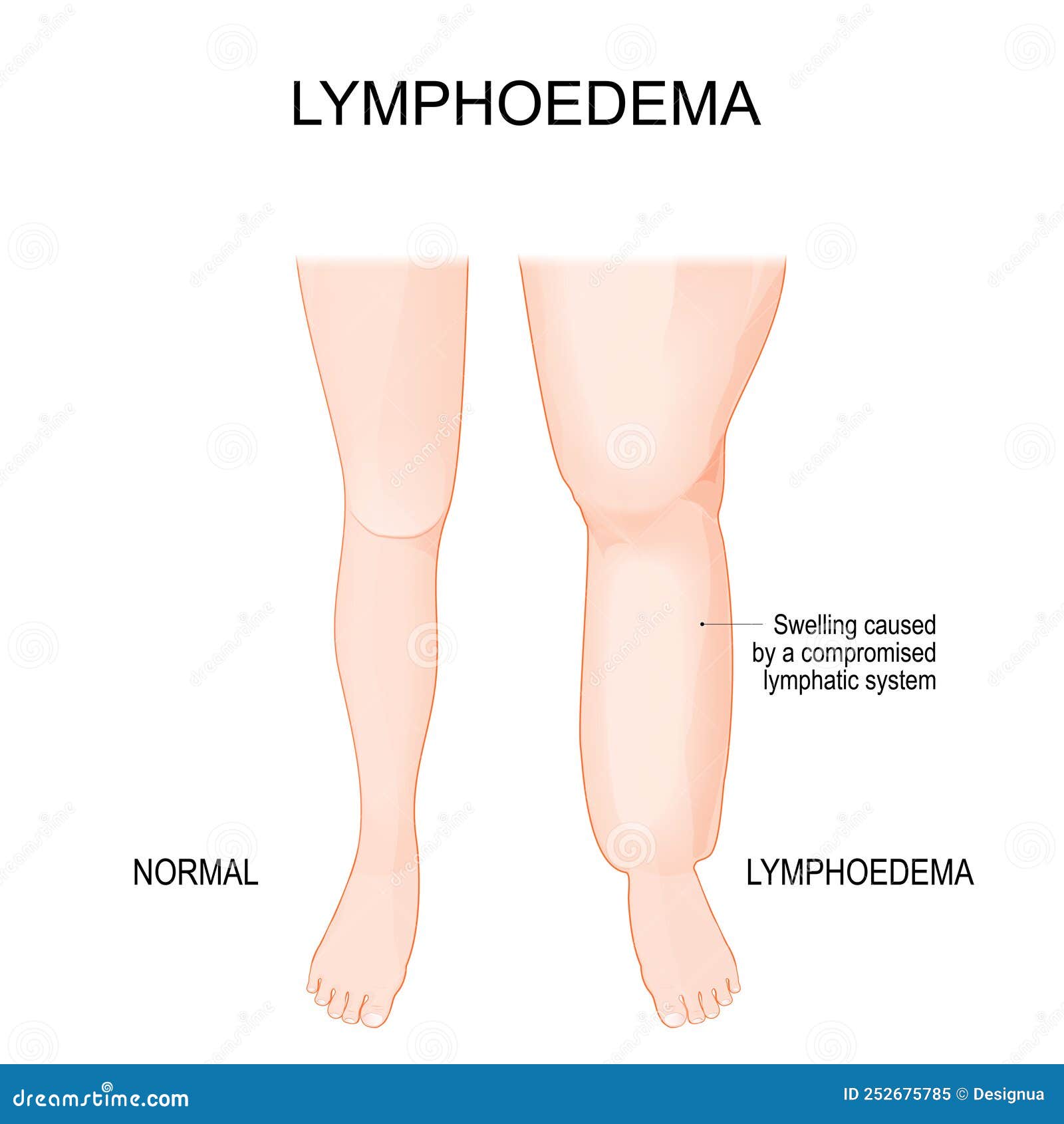 Lymphedema. Lower Extremity Lymphatic Obstruction Stock Vector ...