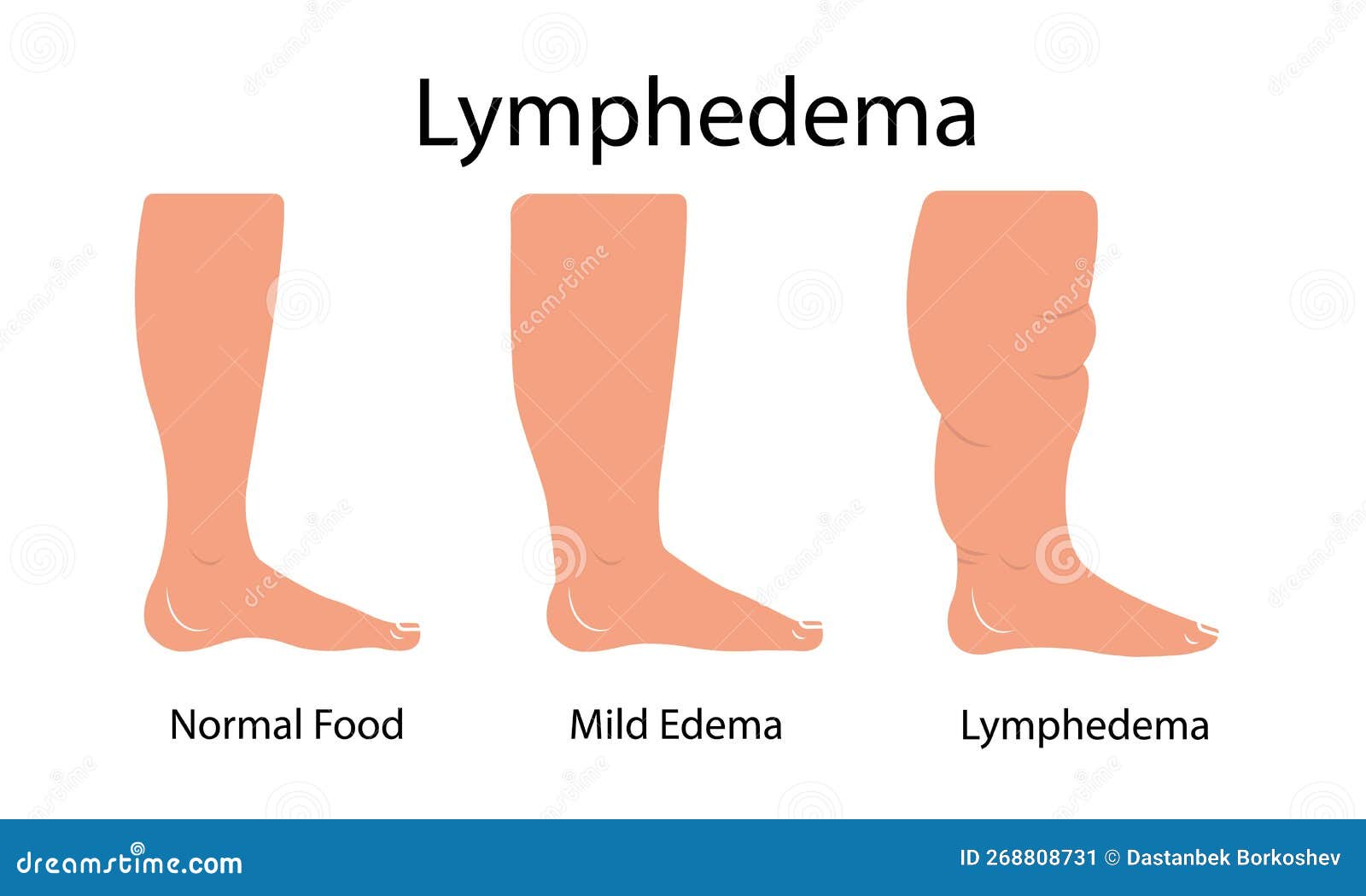 Lymphedema stages stock illustration. Illustration of care - 268808731