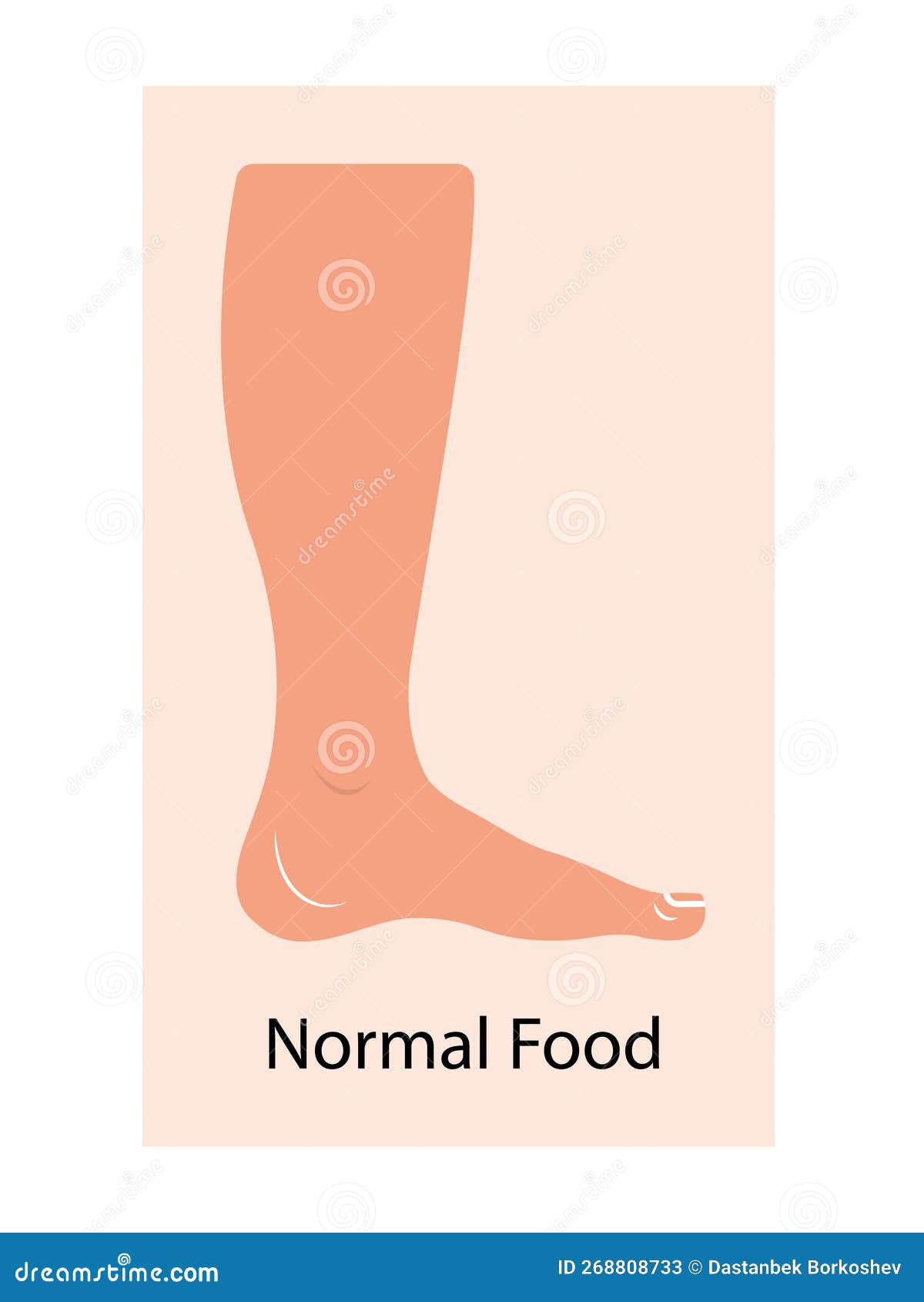 Lymphedema Stages. Lymphatic System Dysfunction Disease. Swollen Legs ... Lymphedema Stages. Lymphatic System Dysfunction Disease. Swollen Legs ...