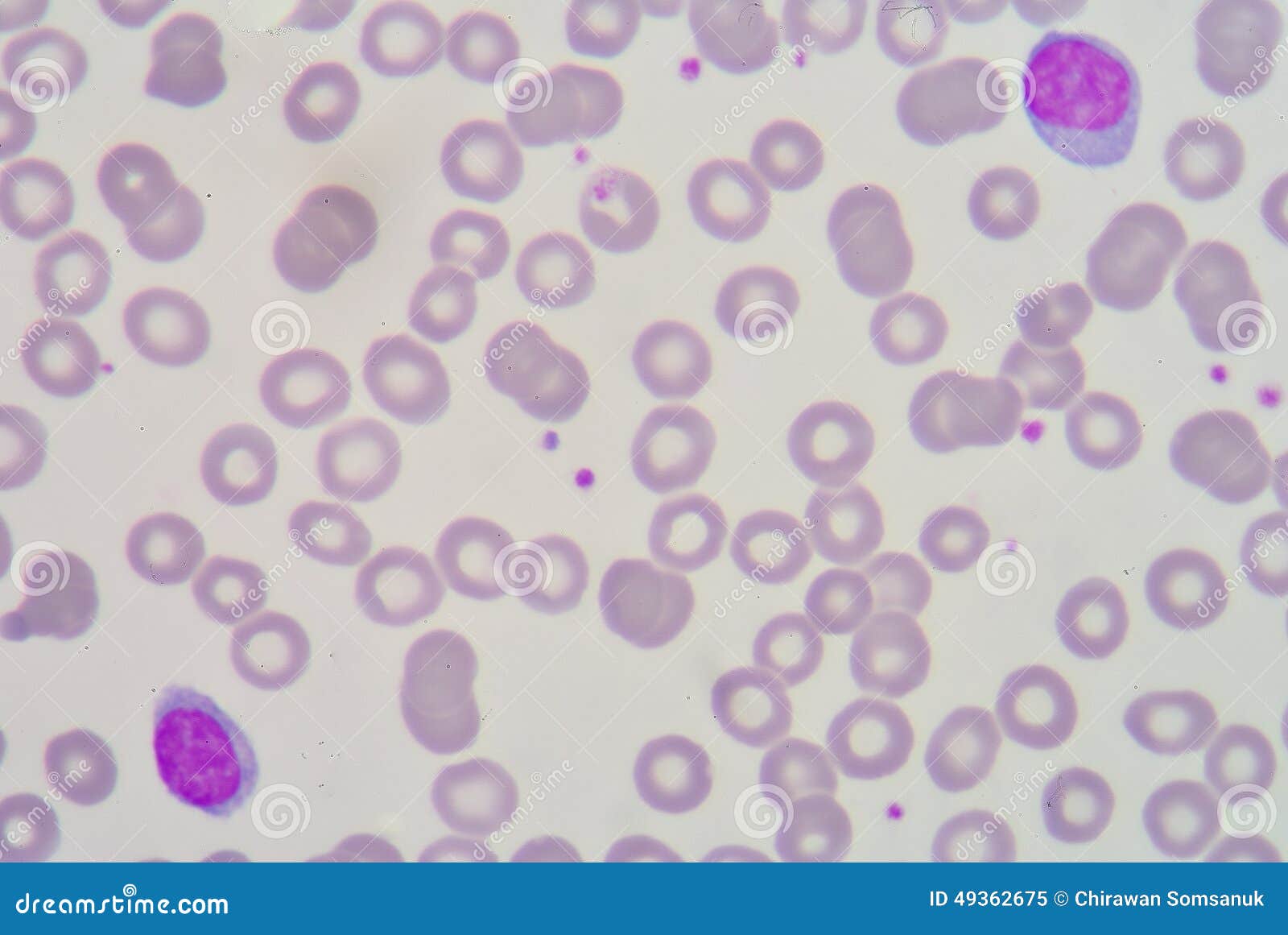 Lymphocyte stock image. Image of basophil, macrocyte - 49362675