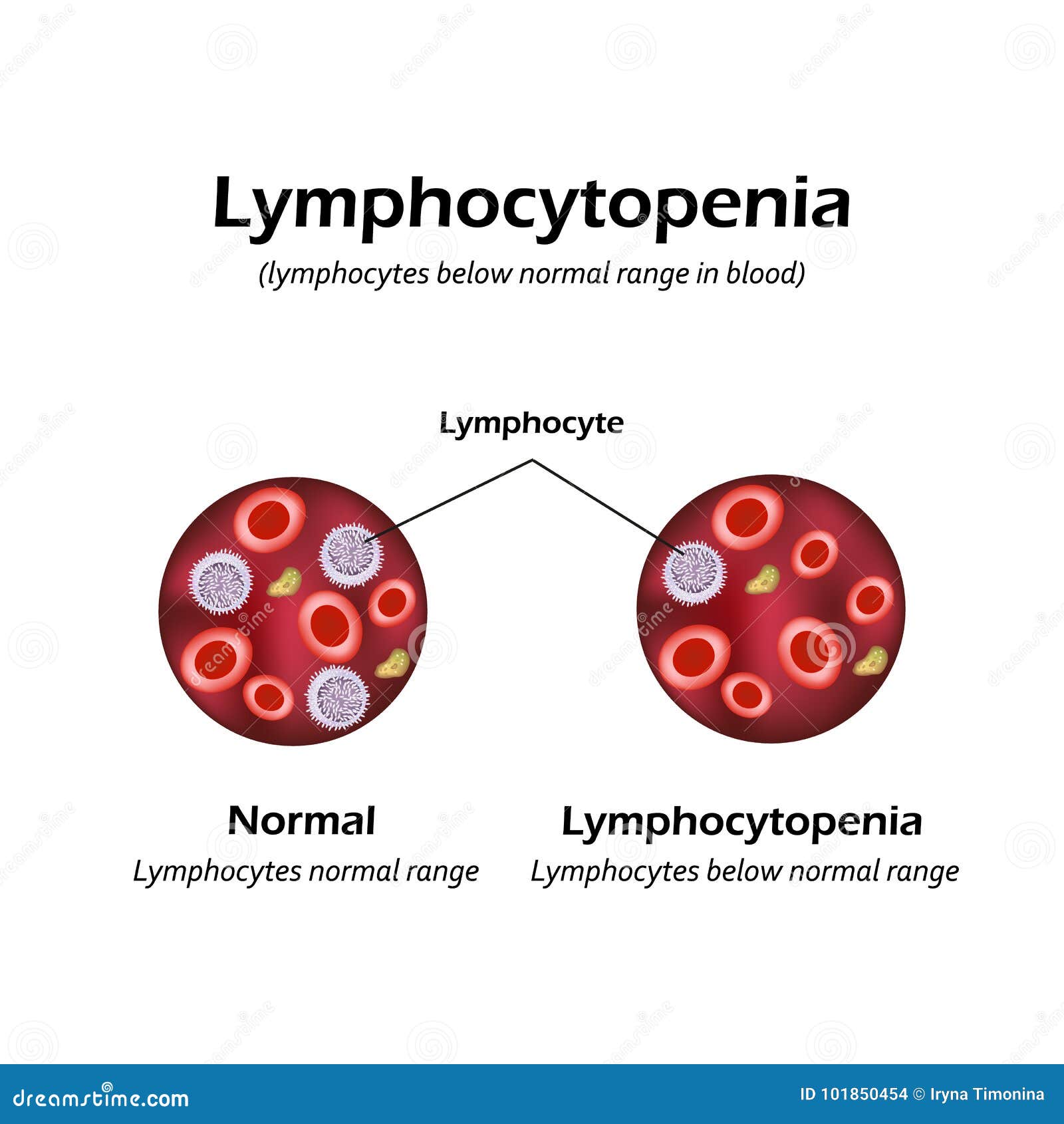 Lymphocytes Below the Normal Range in the Blood. Lymphocytopenia Stock ...