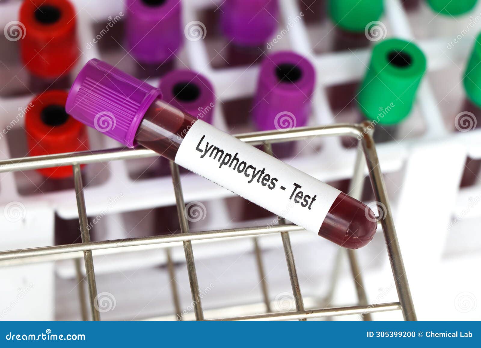 Lymphocytes Test, Blood Sample To Analyze in the Laboratory Stock Photo ...