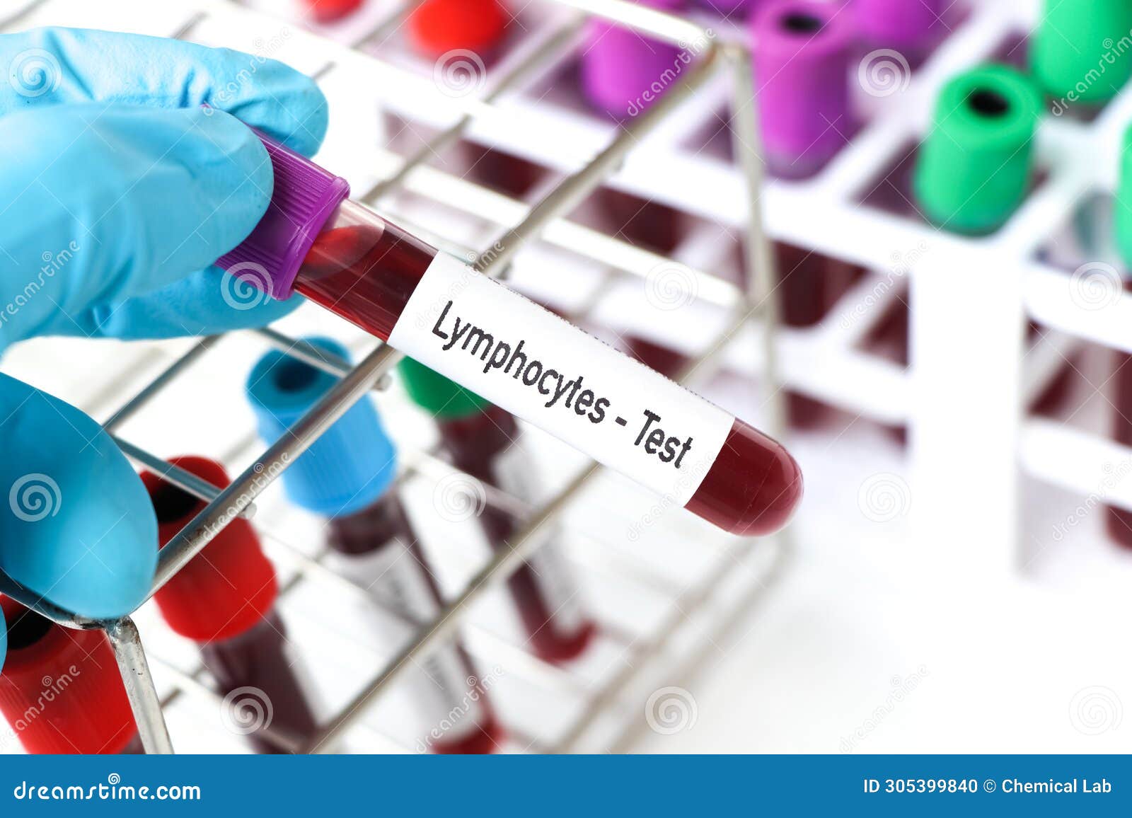 Lymphocytes Test, Blood Sample To Analyze in the Laboratory Stock Photo ...
