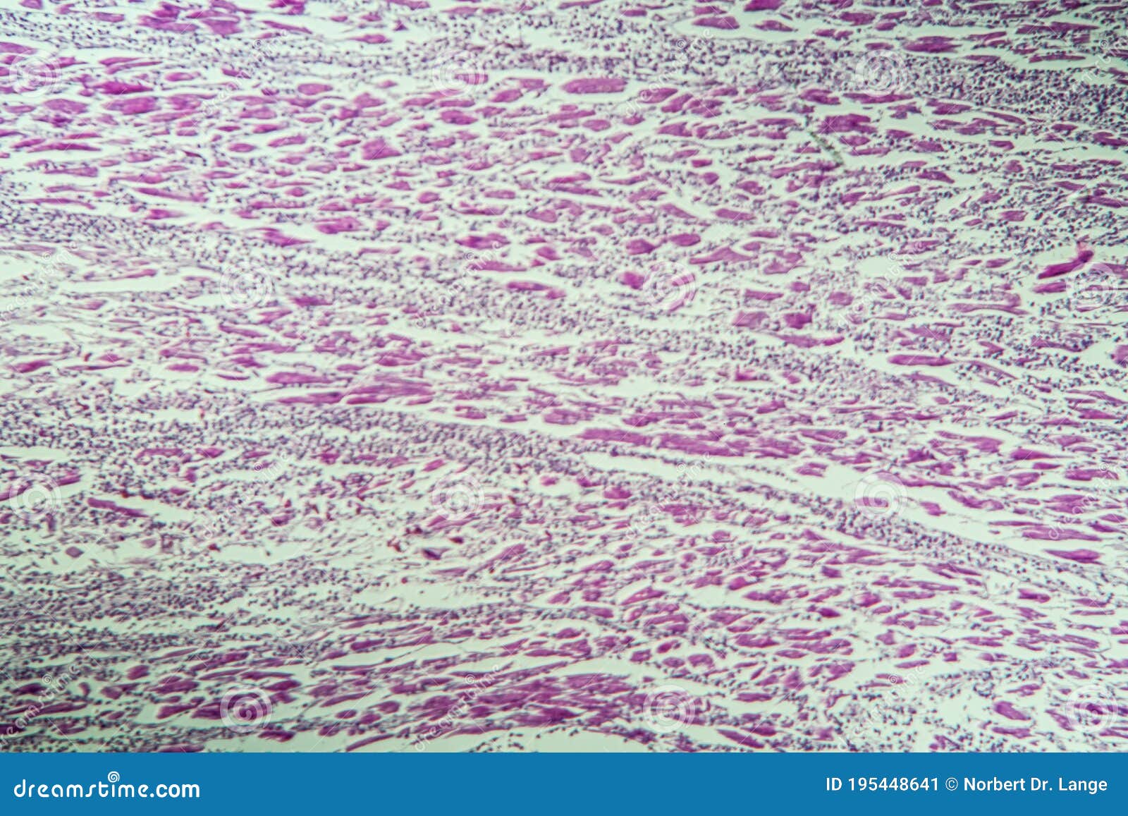 Músculo Cardiaco Inflamado Como Miocarditis Imagen de archivo - Imagen ...