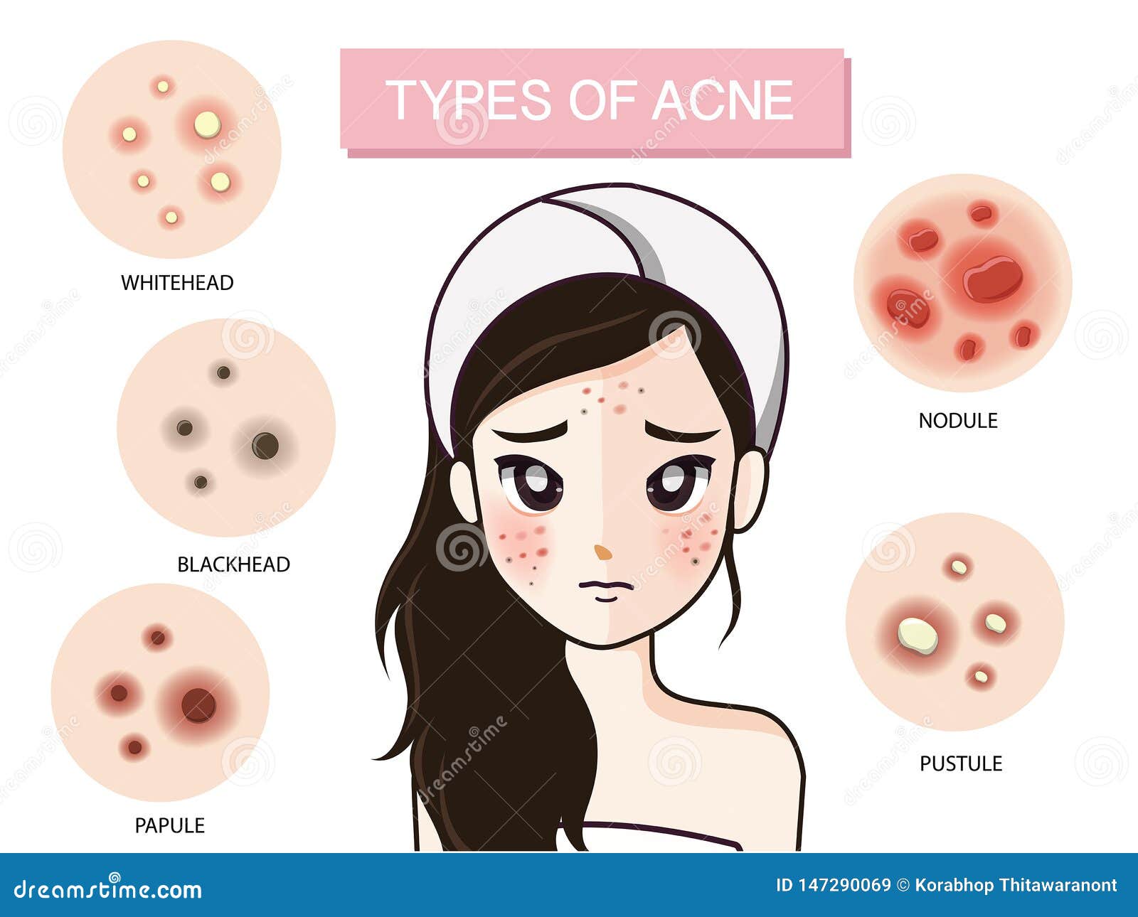 M?dchen und Art der Akne vektor abbildung. Illustration von medizinisch ...