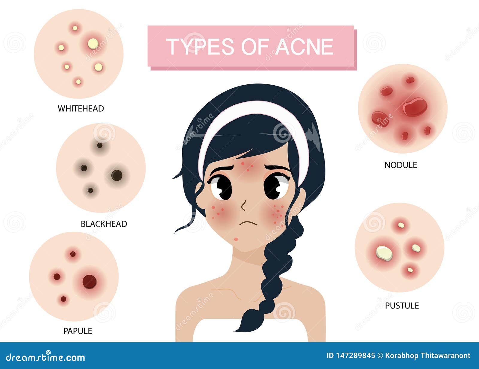 M?dchen und Arten der Akne vektor abbildung. Illustration von ...