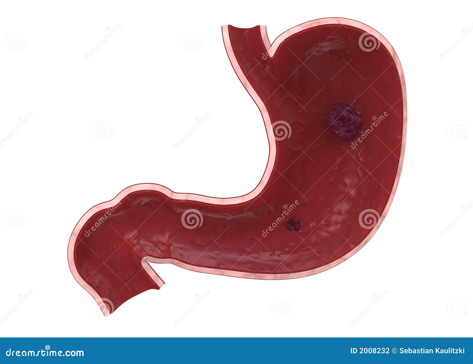 Maag met zweer stock illustratie. Illustration of slijmvlies - 2008232