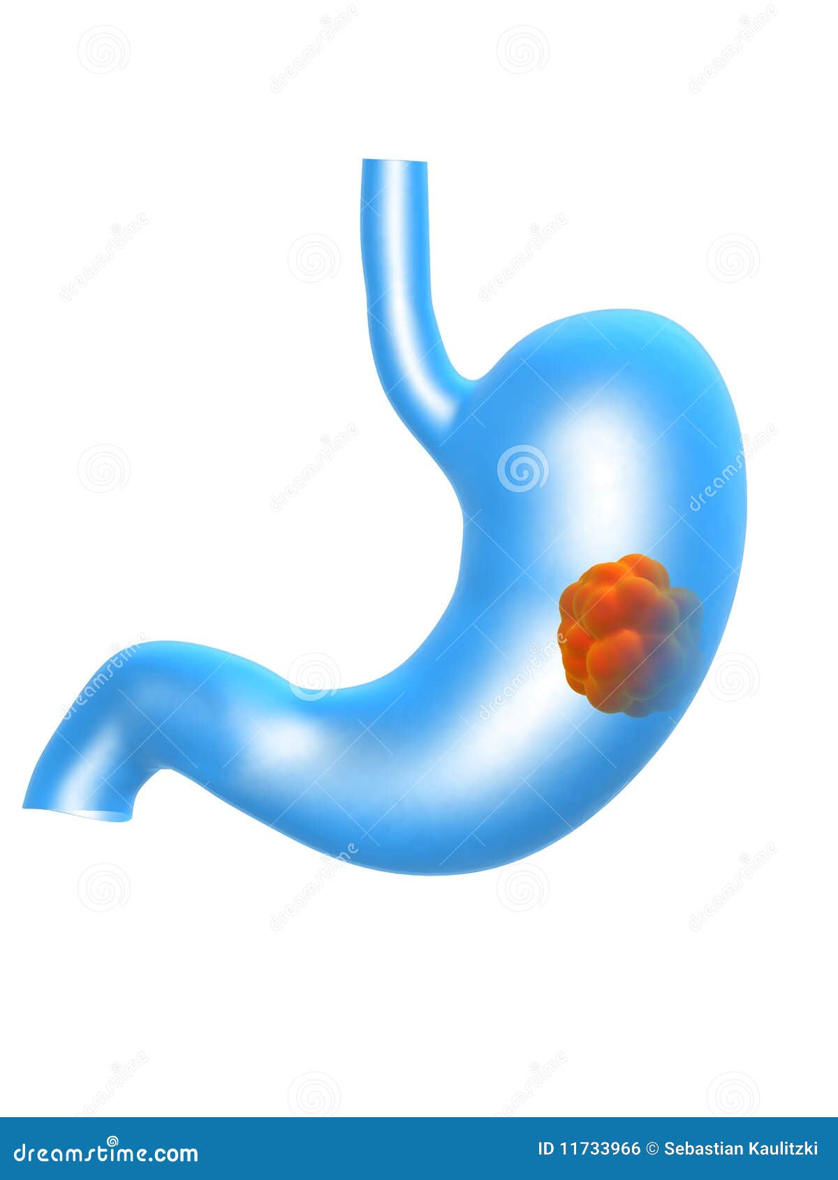 Maagkanker stock illustratie. Illustration of anatomie - 11733966
