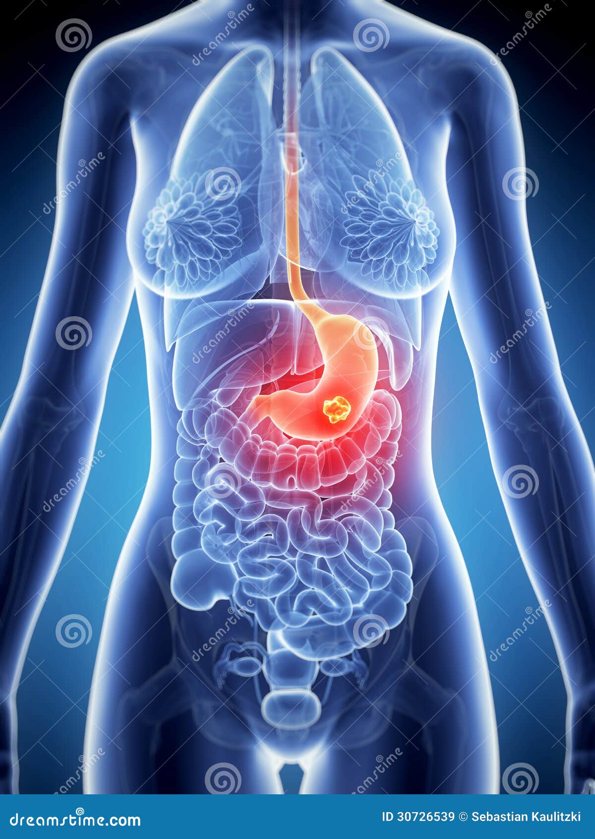 Maagkanker stock illustratie. Illustration of wetenschap - 30726539