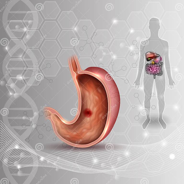 Maagzweer vector illustratie. Illustration of grijs, anatomie - 84159310