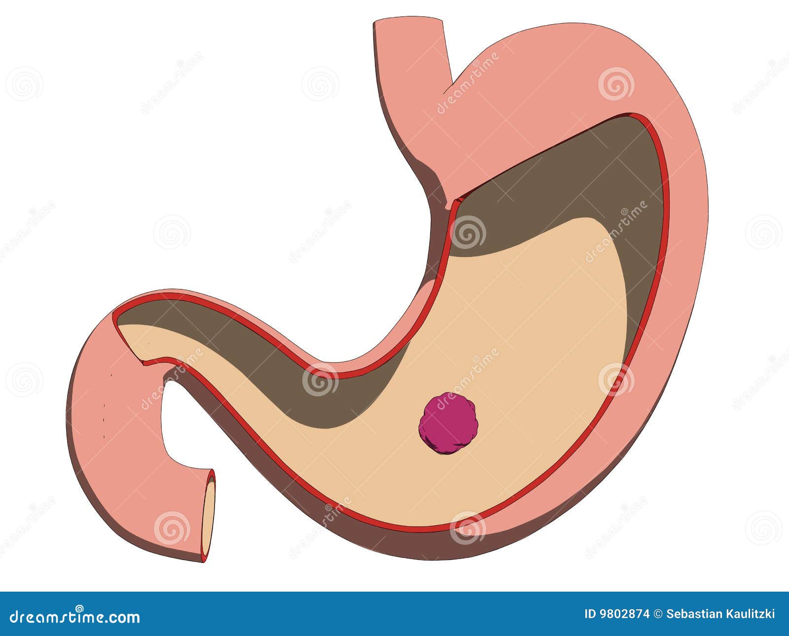 Maagzweer vector illustratie. Illustration of anatomie - 9802874