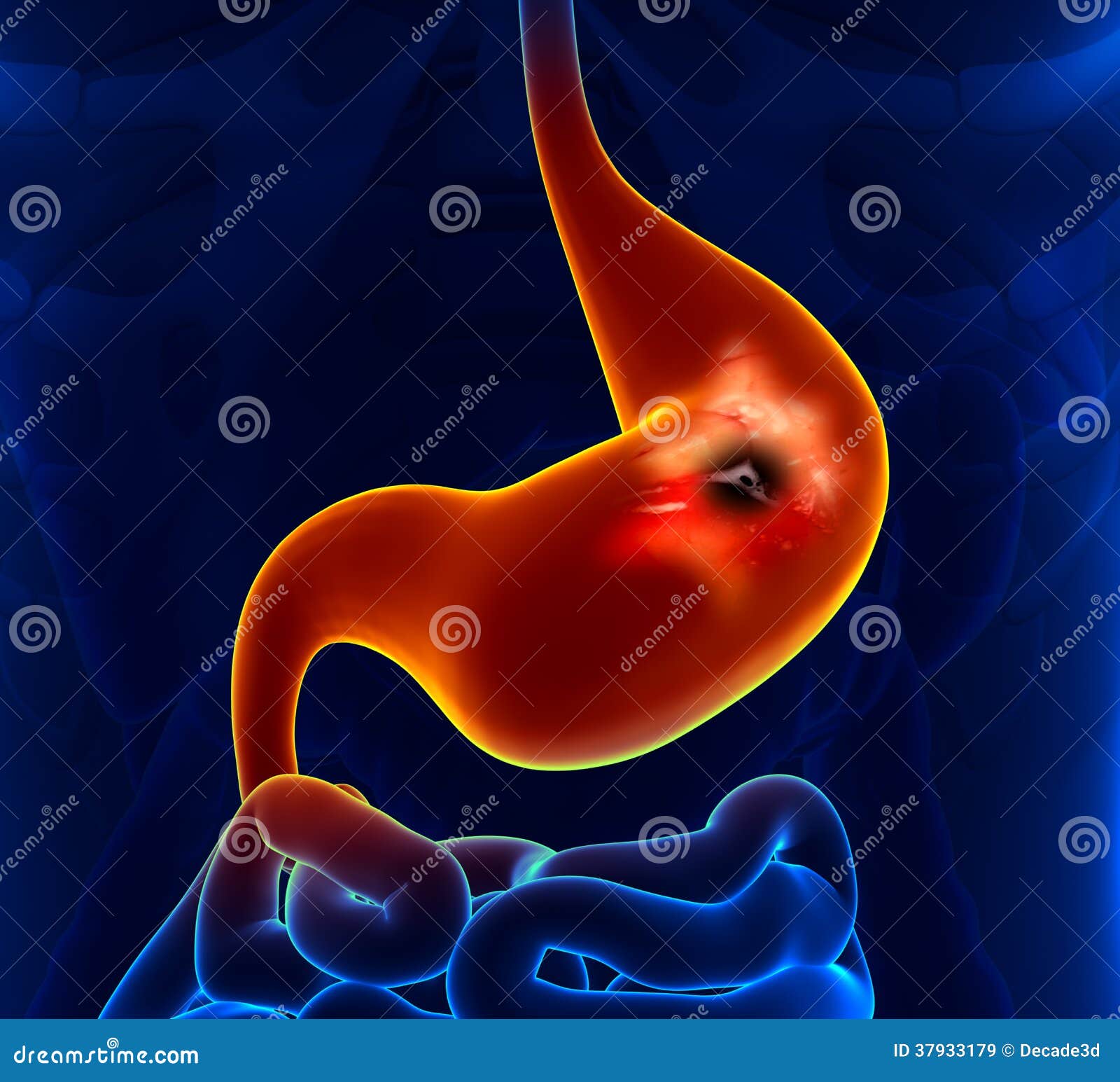 Maagzweer - Maagprobleem stock illustratie. Illustration of ...