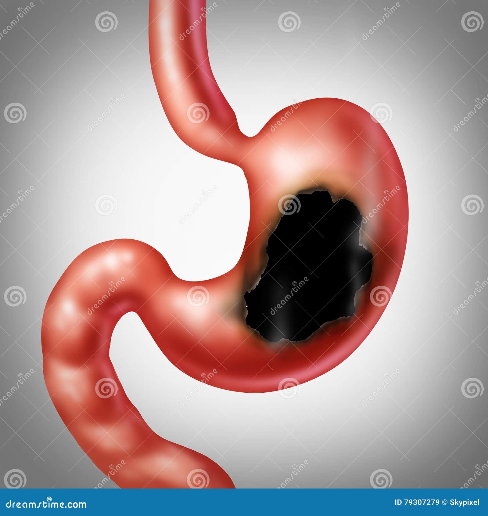 Maagzweer Medisch Concept stock illustratie. Illustration of onwel ...