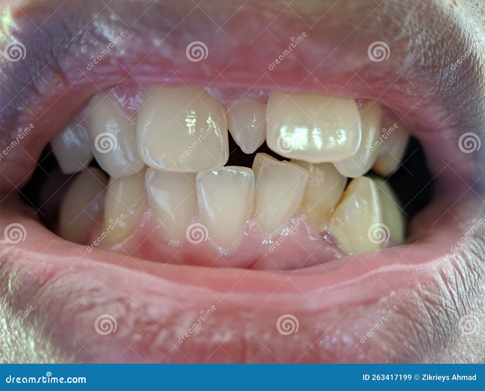 Macro of Crooked Teeth Texture Stock Image - Image of mouth, face ...