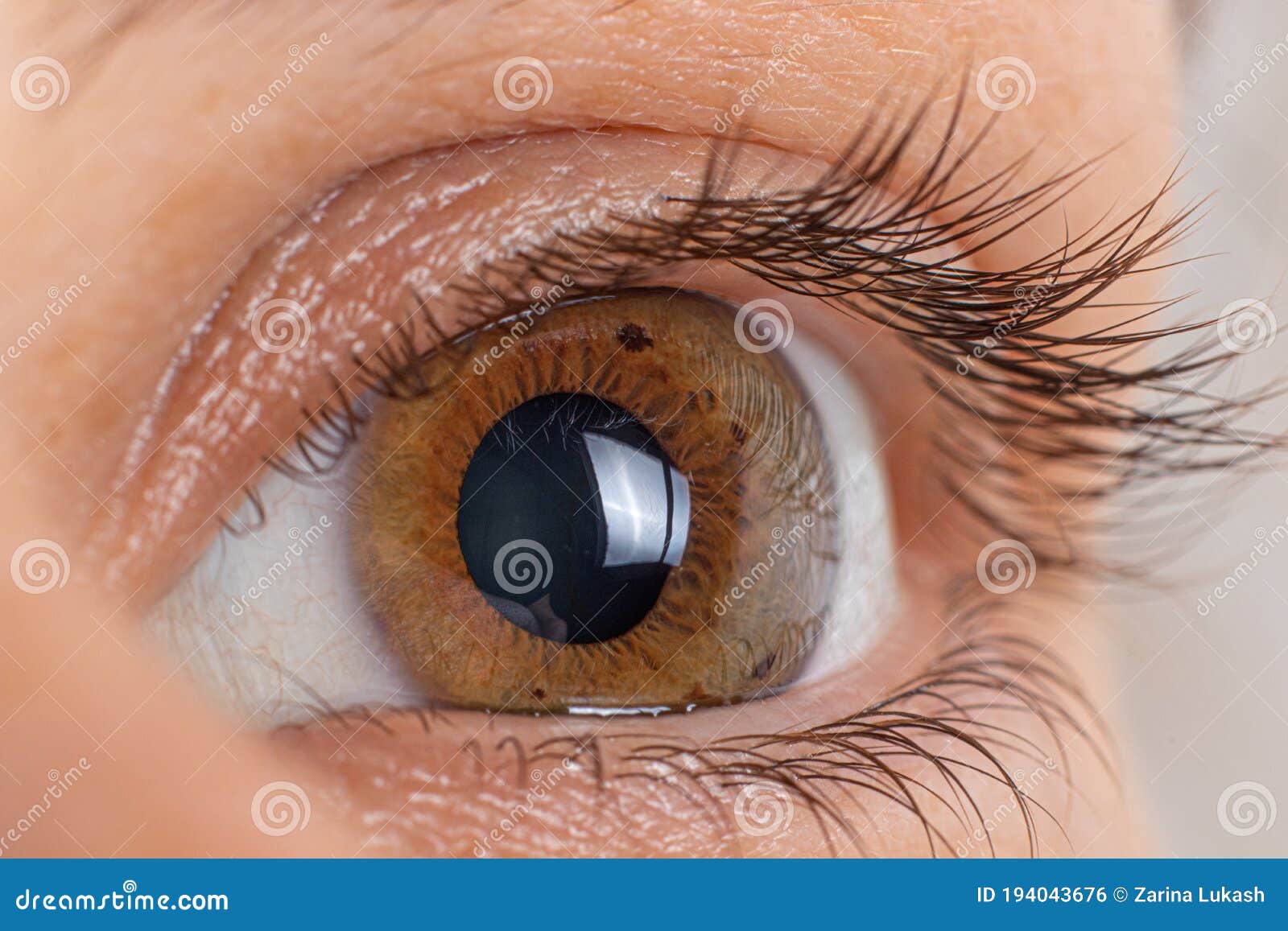 Macro Eye Photo. Keratoconus 2 Degree - Eye Disease, Thinning of the ...