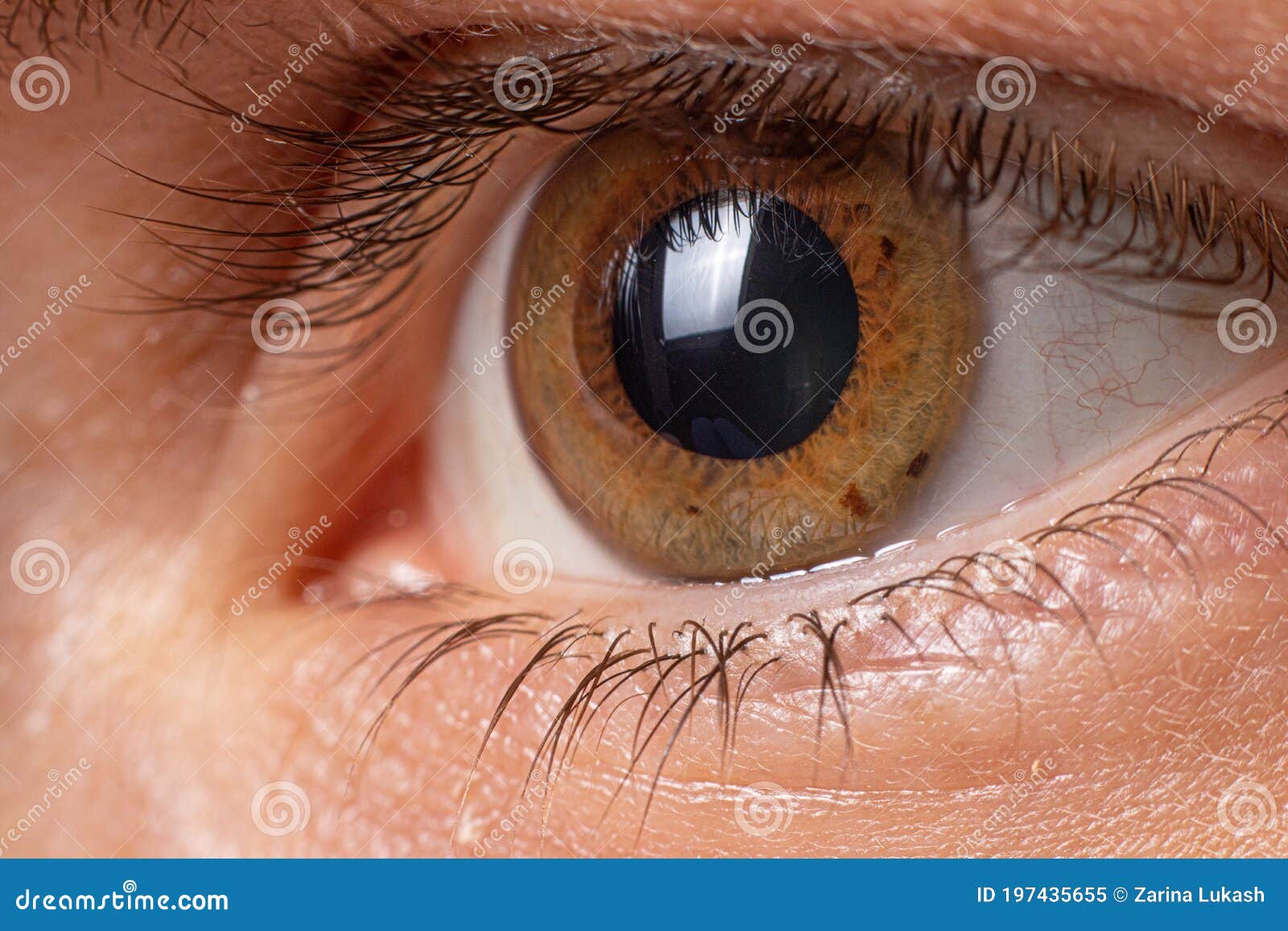 Macro Eye Photo. Keratoconus - Eye Disease, Thinning of the Cornea in ...