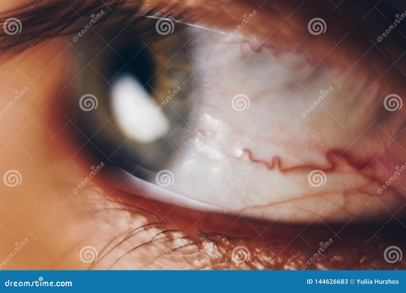 Macro Eyes with Bursting Red Blood Vessels. Eyeball Covered with Blood ...