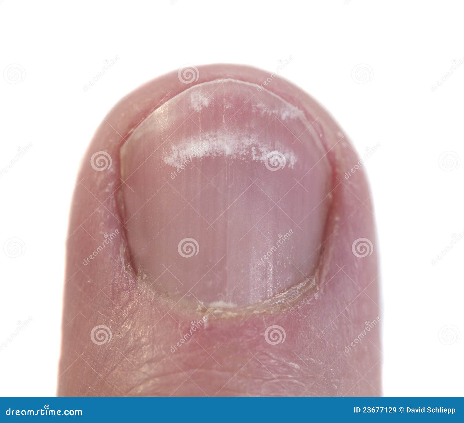 Macro of a Fingernail with Leukonychia Stock Image - Image of digit ...