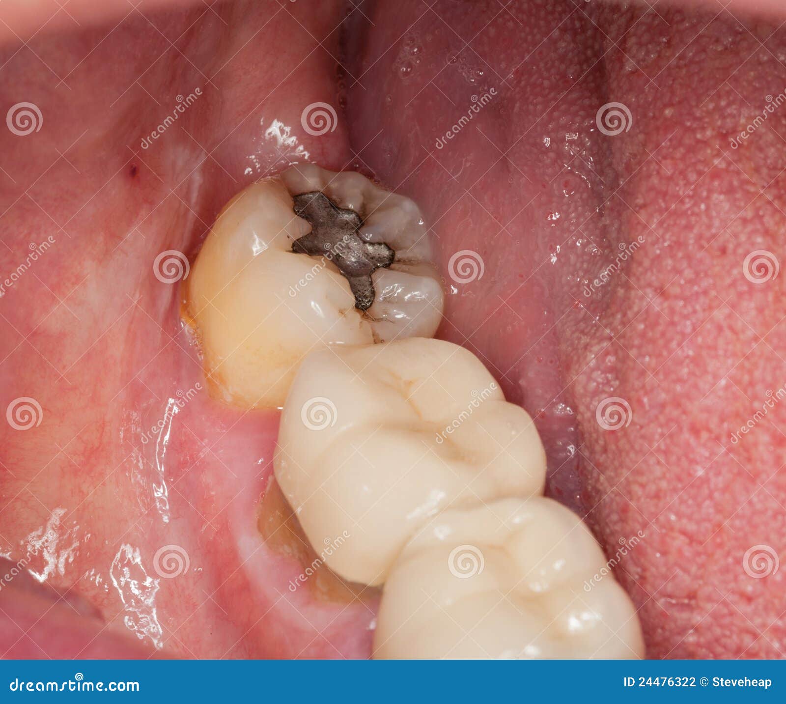 Macro Image of Filled Teeth Stock Photo - Image of caries, closeup ...