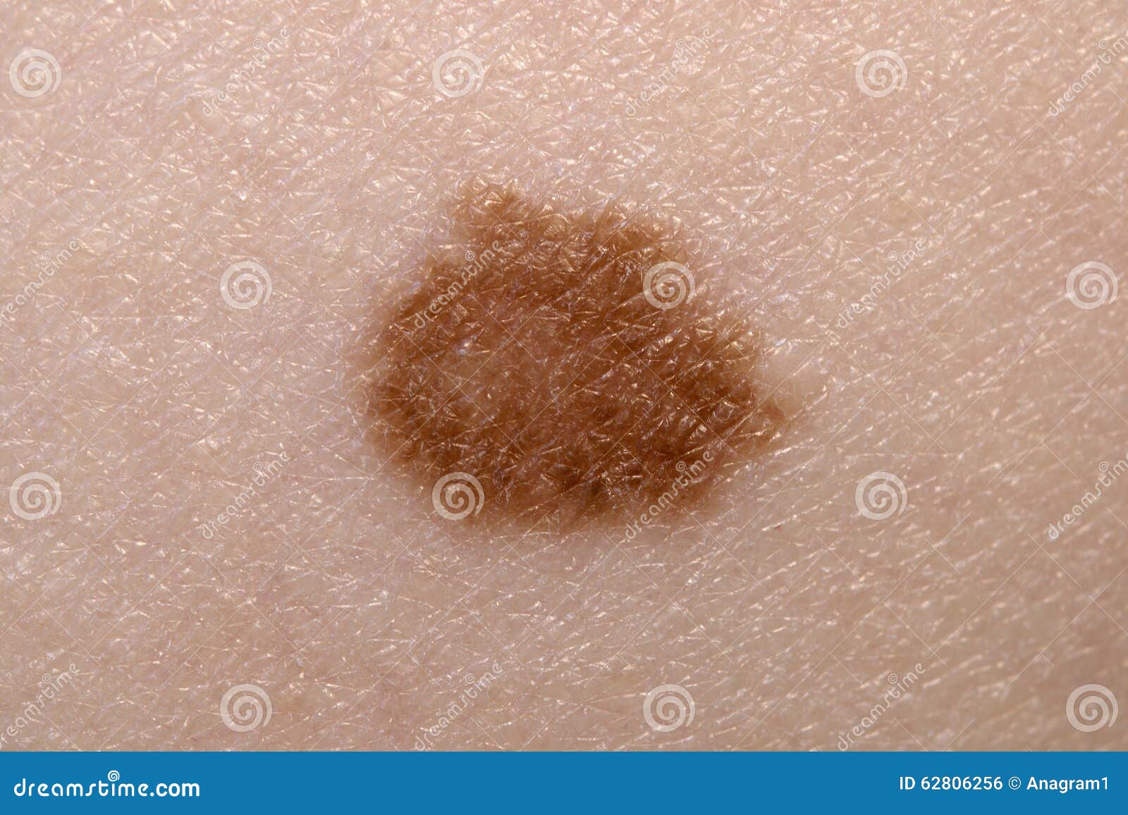 Macro Shot of a Big Skin Mole Stock Photo - Image of cell, displeased ...