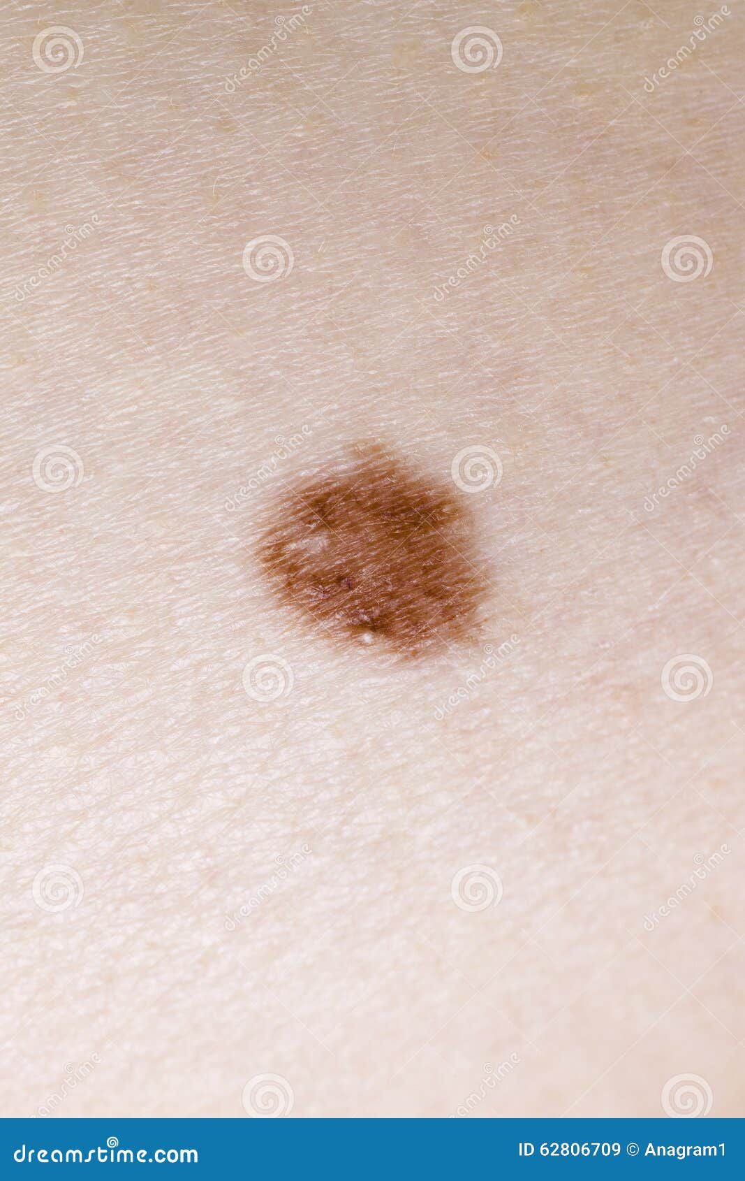 Macro Shot of a Big Skin Mole Stock Image - Image of health ...