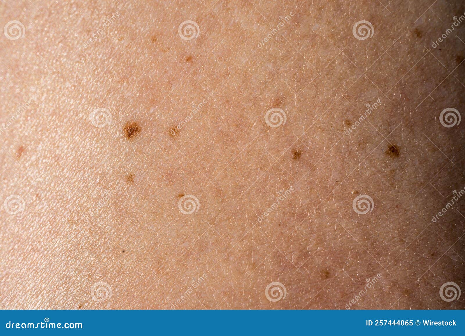Macro Shot of the Human Skin with Nevi, Moles. Stock Image - Image of ...