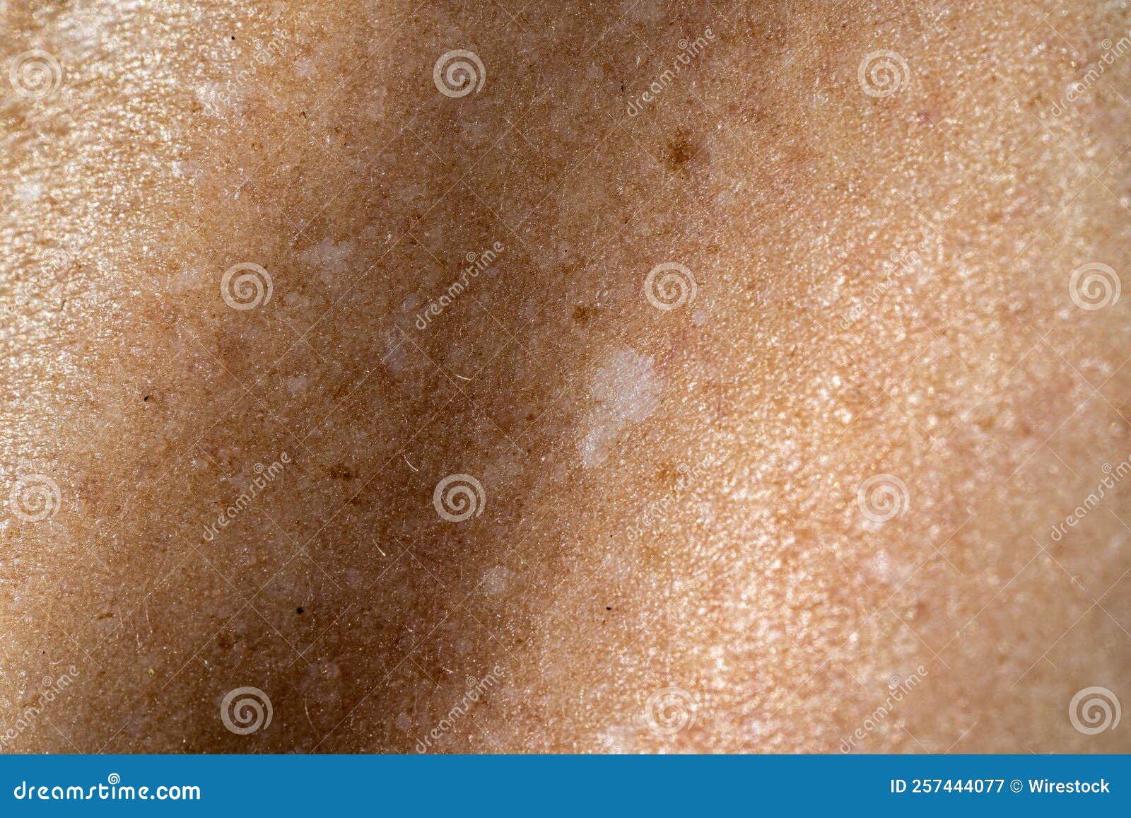 Macro Shot of the Human Skin with Nevi, Moles. Stock Image - Image of ...