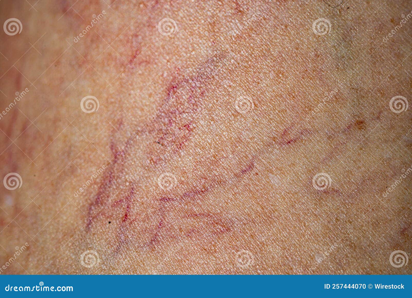 Macro Shot of the Human Skin with Veins. Stock Photo - Image of beauty ...