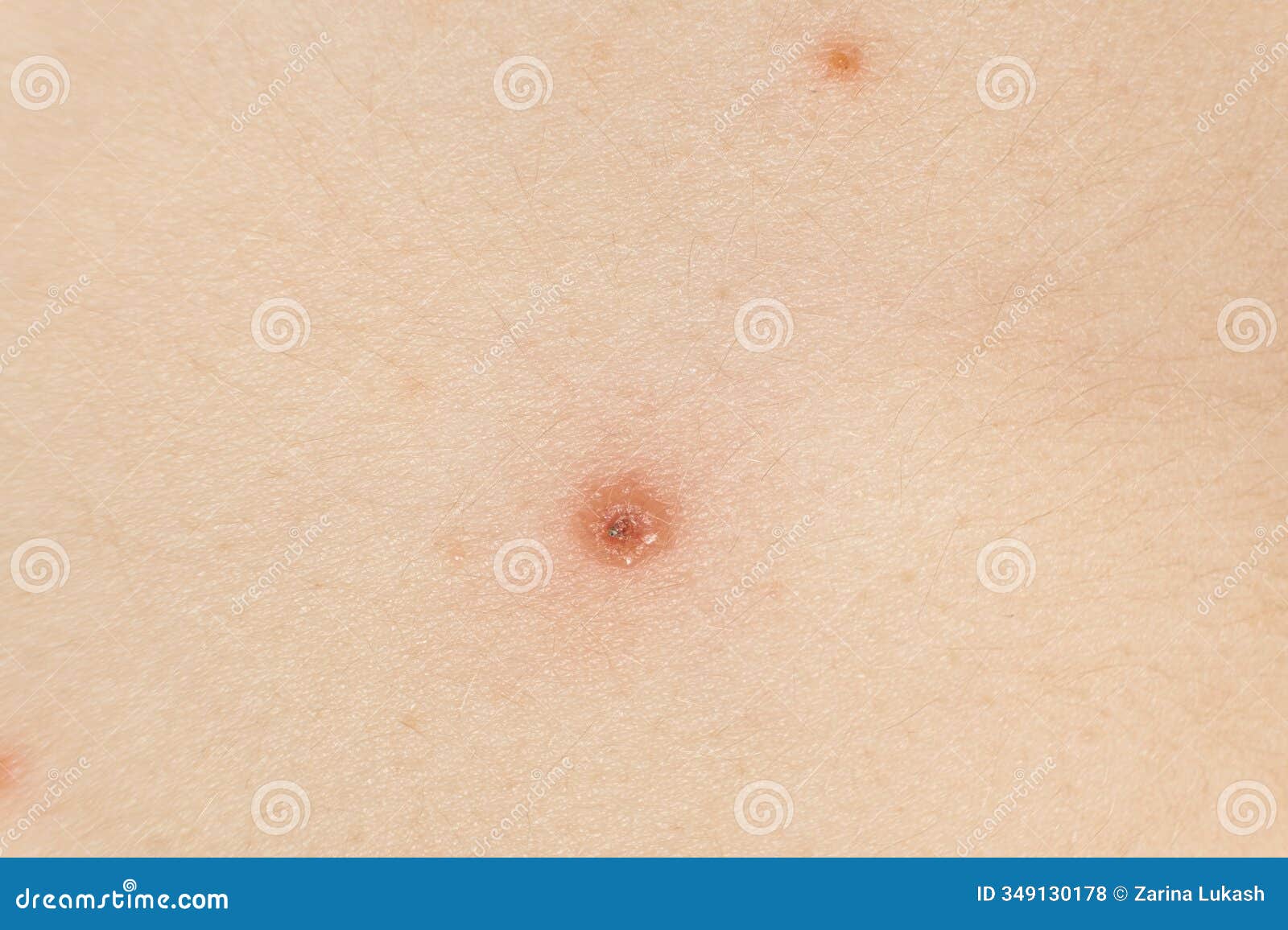 Macro Skin with Chickenpox, Vesicles at Different Stages. Stock Photo ...