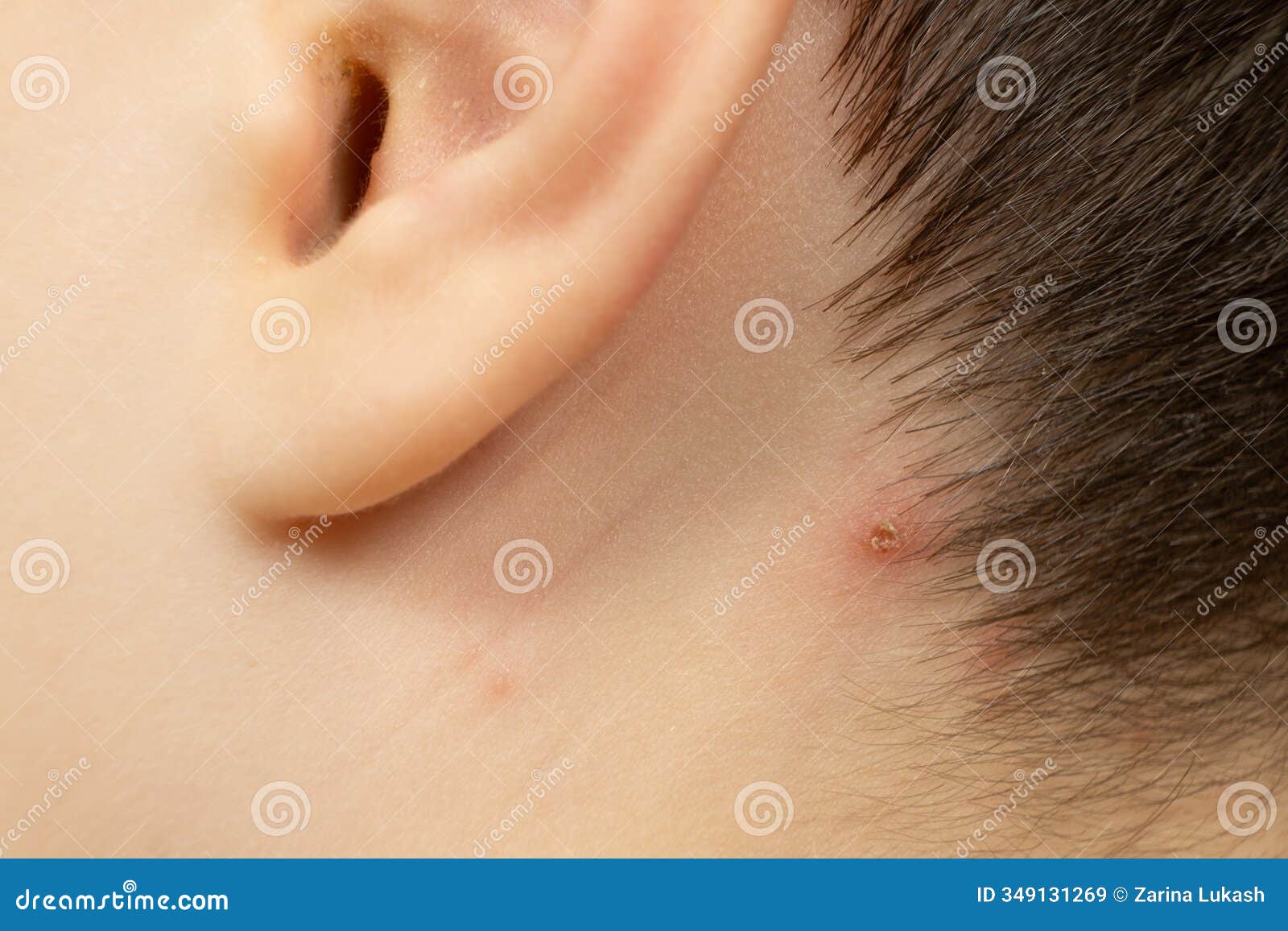 Macro Skin with Chickenpox, Vesicles at Different Stages. Stock Image ...