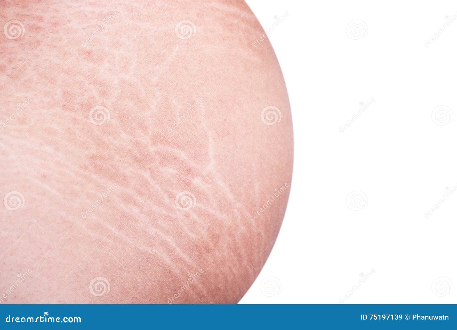 Macro Stretch Marks of Skin on the Belly Isolated on White Stock Image ...