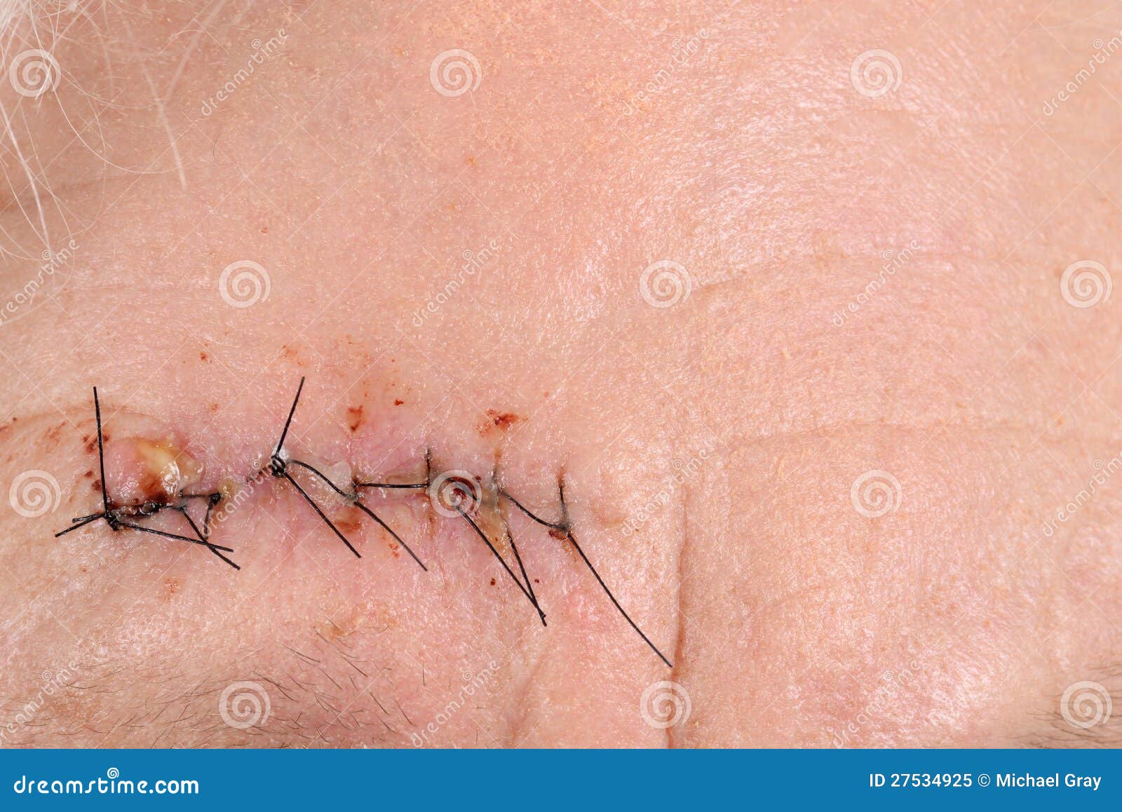 Macro sutures on forehead stock image. Image of operation - 27534925