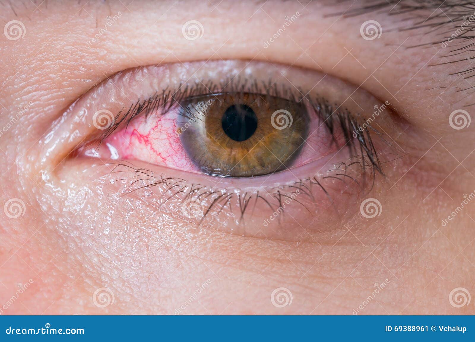 Macro Van Bindvliesontstekings Rood Oog Stock Afbeelding - Image of ...