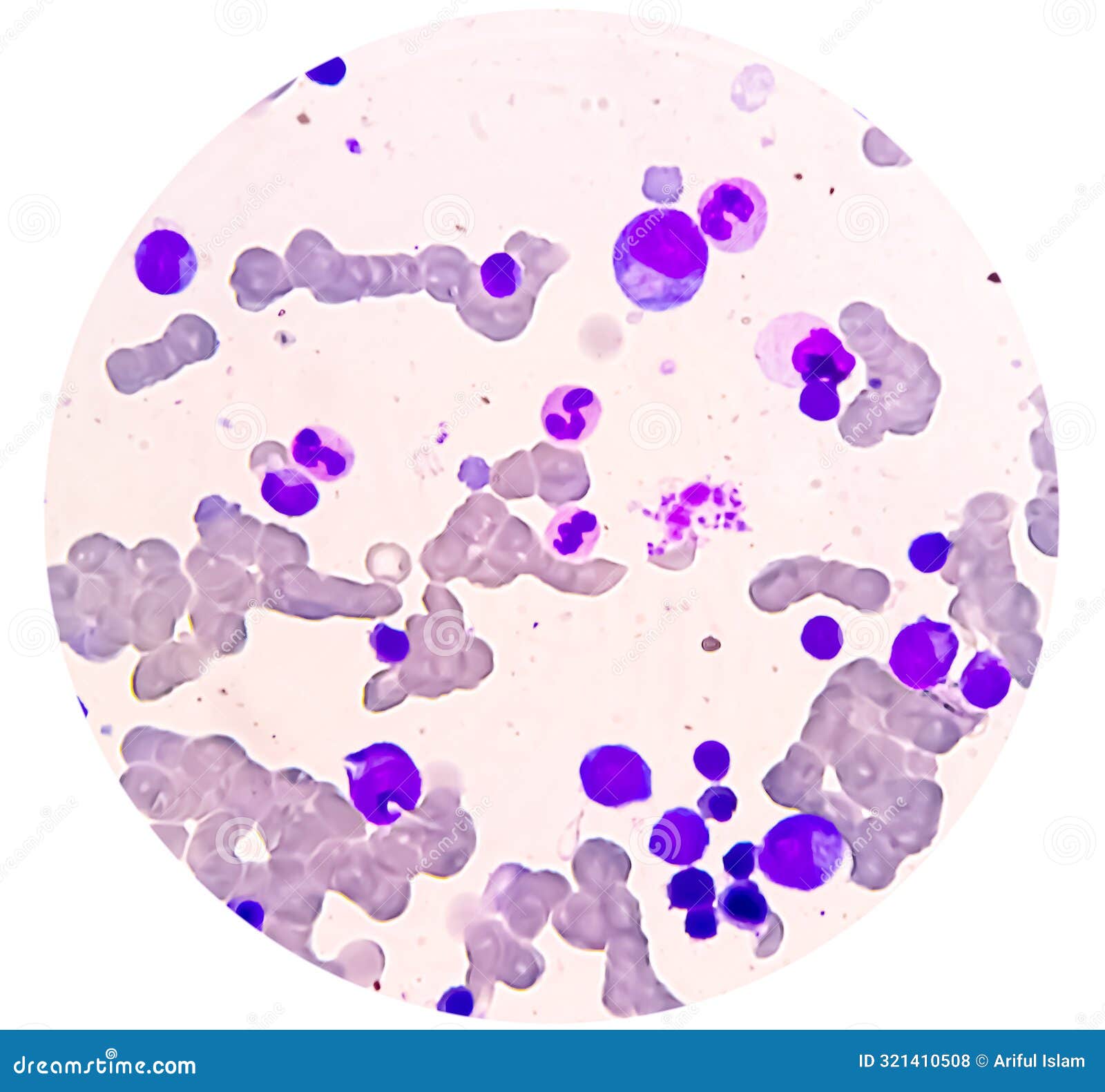 Abnormal white blood cell stock photo. Image of healthcare - 321410508