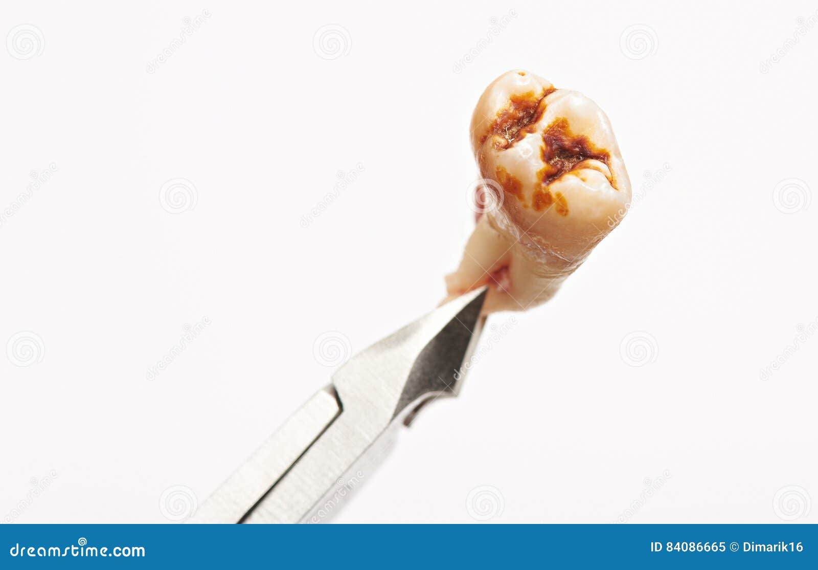 Macro of Yeelow Teeth with Cavity Stock Image - Image of composite ...