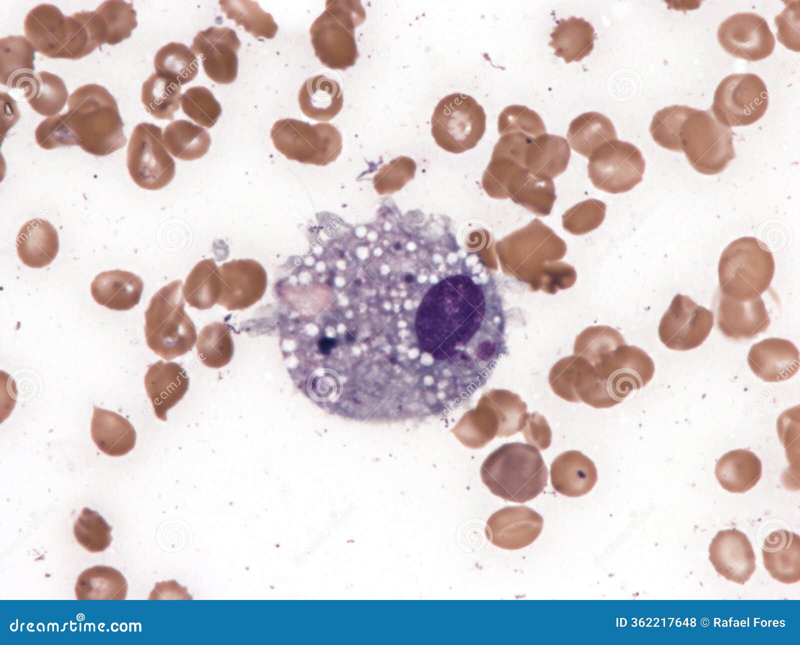 Macrophage in bone marrow. stock photo. Image of engulf - 362217648