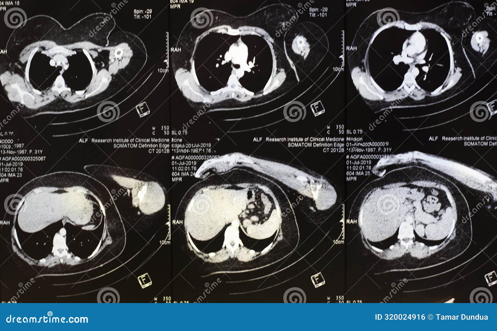 Computer Tomography Of Chest And Abdomen Royalty-Free Stock Image ...