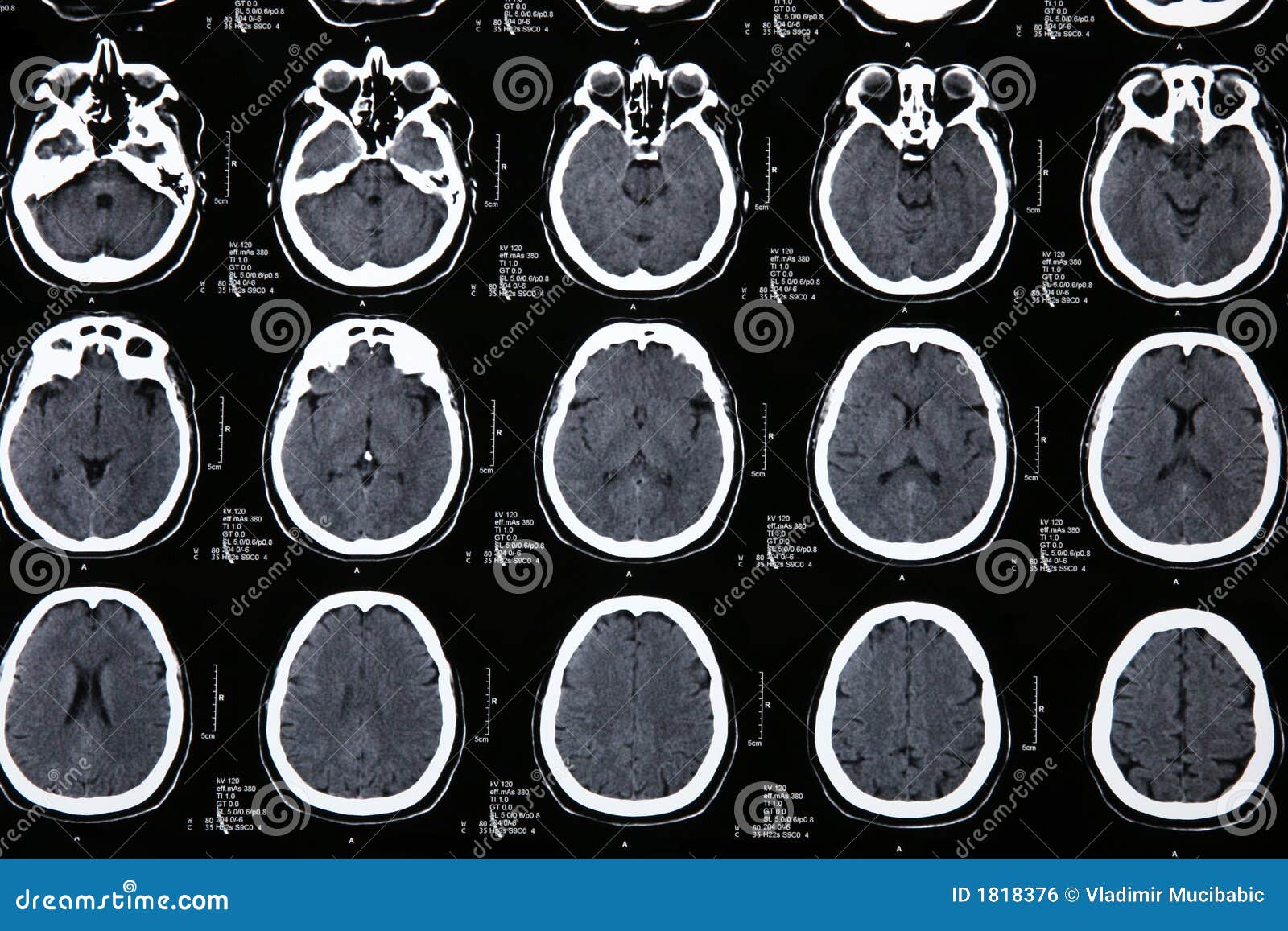Magnetic Resonance of a Brain Stock Photo - Image of head, radiation ...