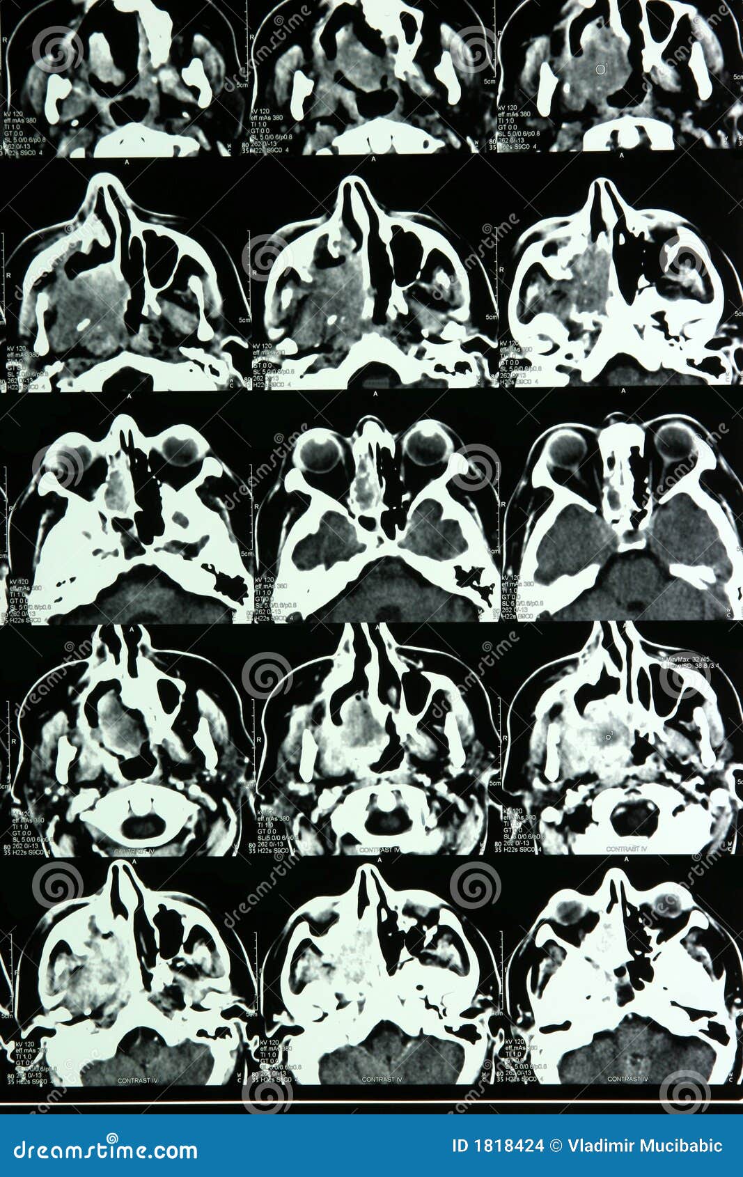 Magnetic Resonance of a Brain Stock Photo - Image of injury, parts: 1818424