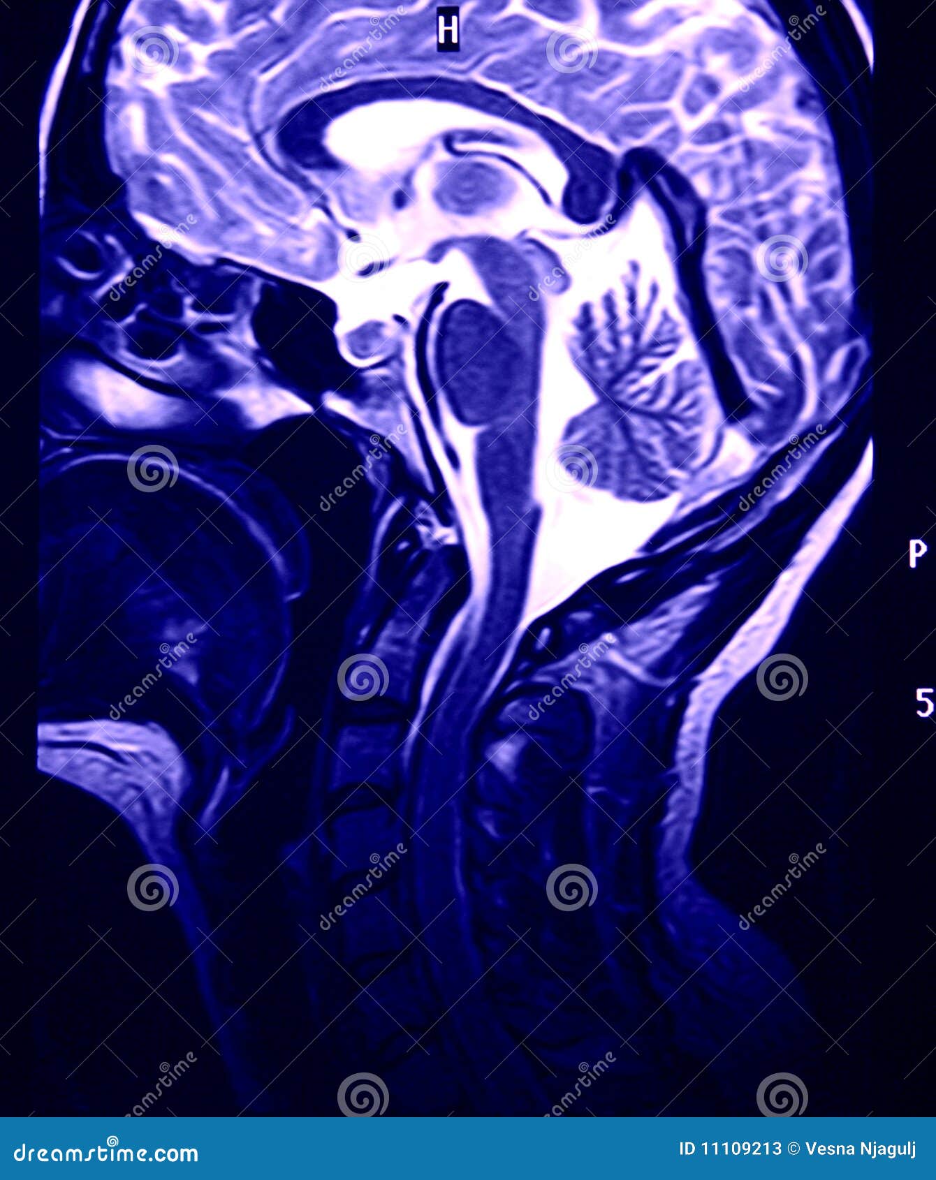 Magnetic Resonance of Brain, Blue MR Stock Image - Image of headache ...